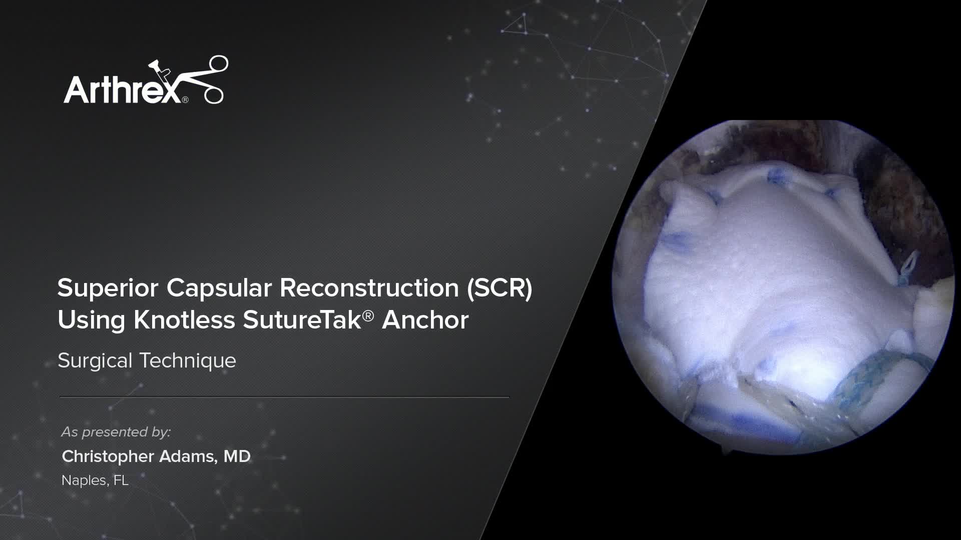 Arthrex - Superior Capsular Reconstruction (SCR) Using Knotless ...