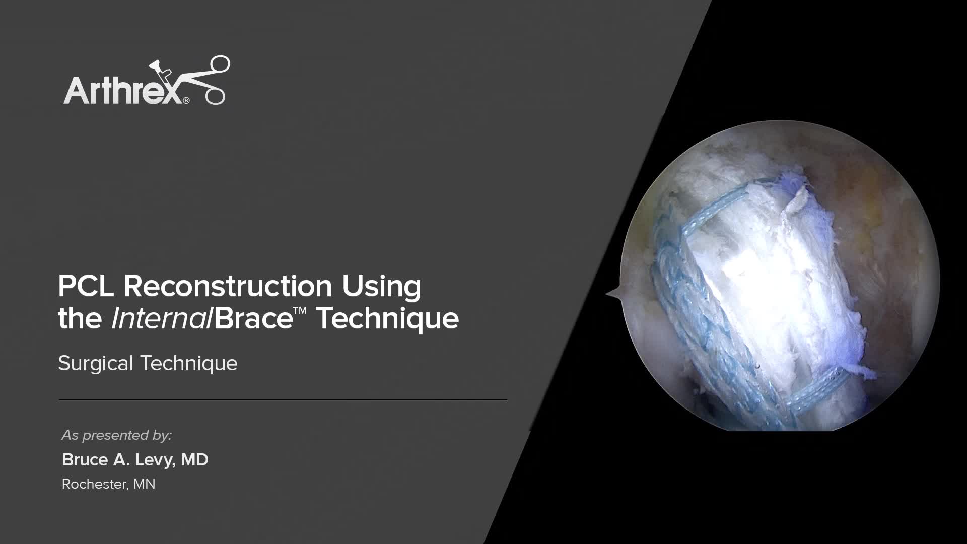 Arthrex - PCL Reconstruction Using the InternalBrace™ Technique
