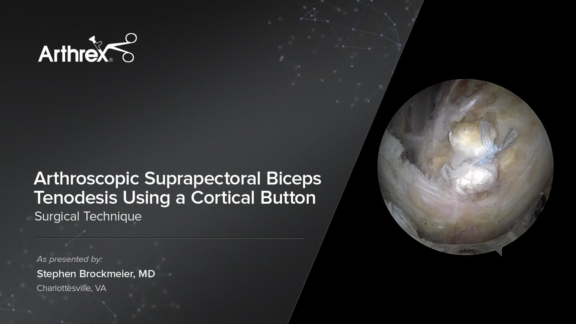 Arthrex - Arthroscopic Suprapectoral Biceps Tenodesis Using a Cortical ...