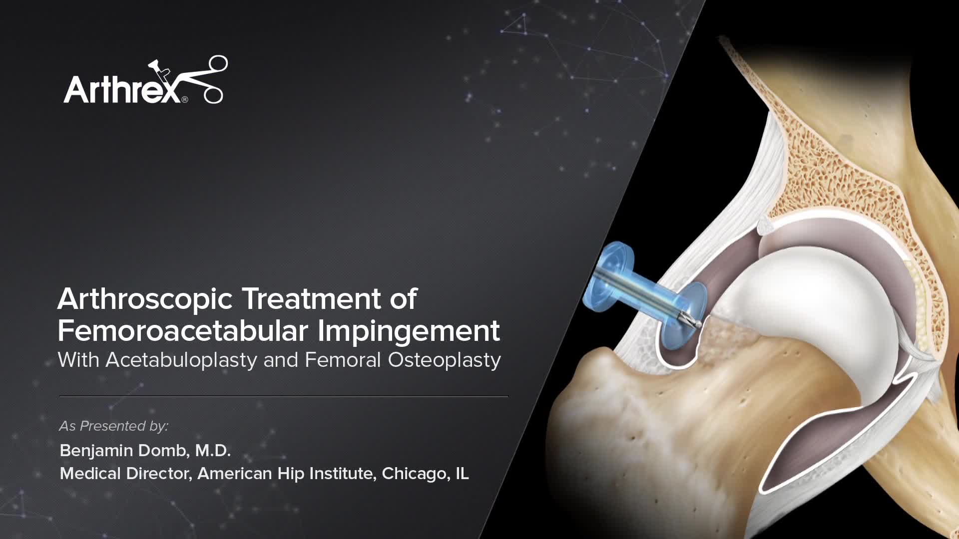 Arthrex - Treating FAI Surgical Technique