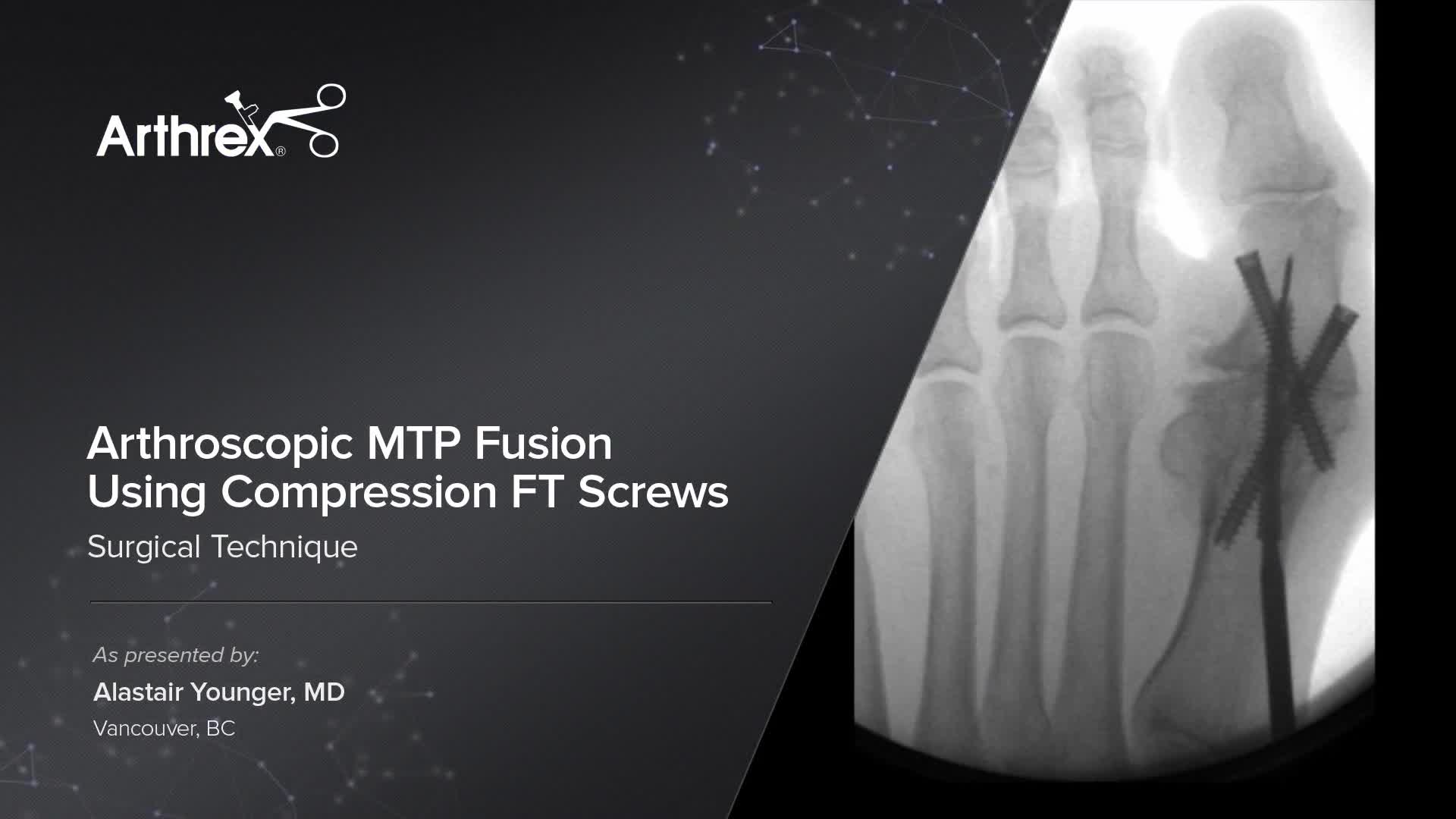 Arthrex - Arthroscopic MTP Fusion Using Compression FT Screws