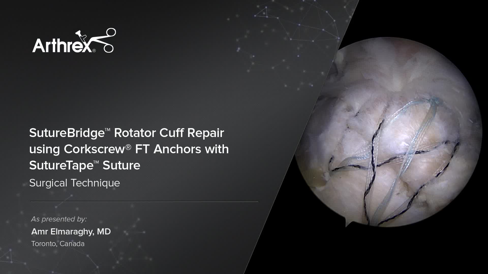 Arthrex - SutureBridge™ Rotator Cuff Repair using Corkscrew® FT Anchors ...