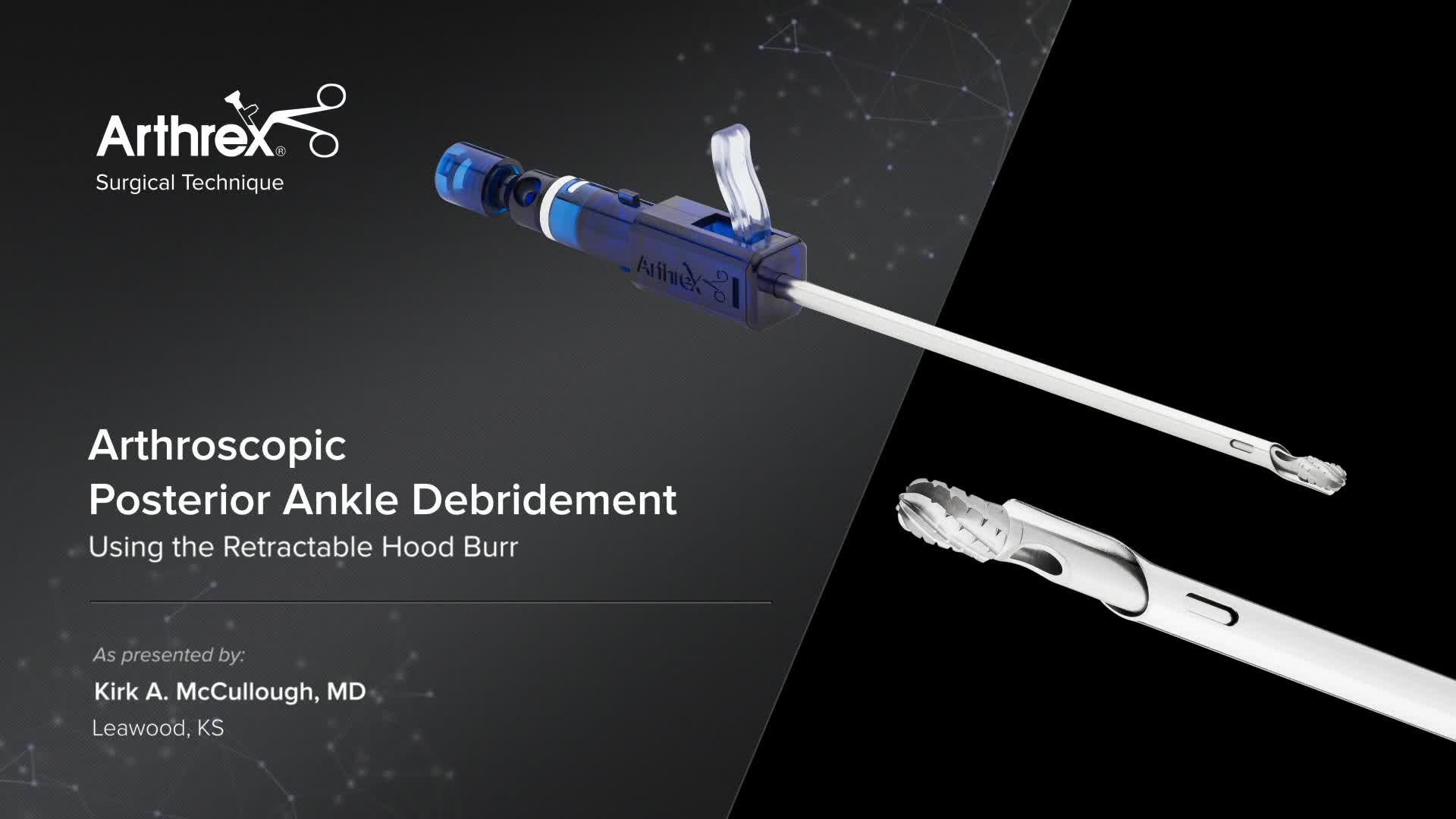 Arthrex - Arthroscopic Posterior Ankle Debridement Using the ...