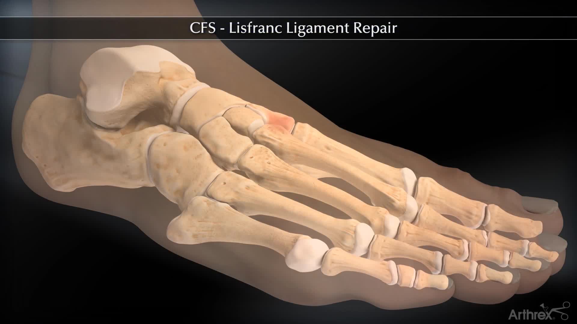 Arthrex - CFS Lisfranc Ligament Repair