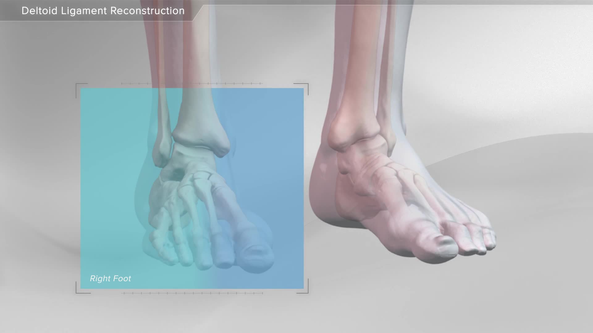 Arthrex - Deltoid Ligament Reconstruction