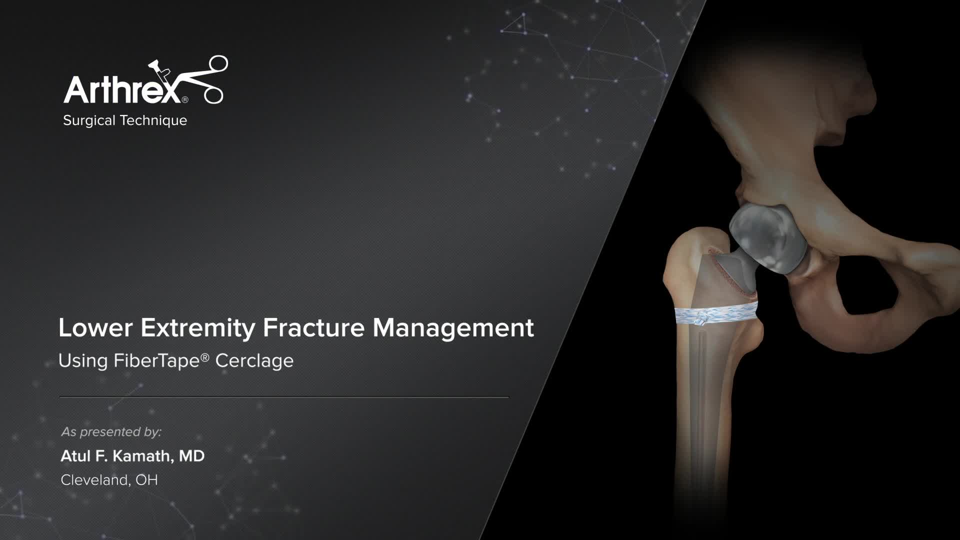Arthrex - Lower Extremity Fracture Management Using FiberTape® Cerclage