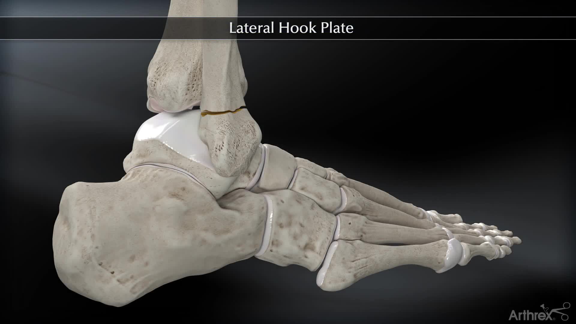 Arthrex - Lateral Hook Plate