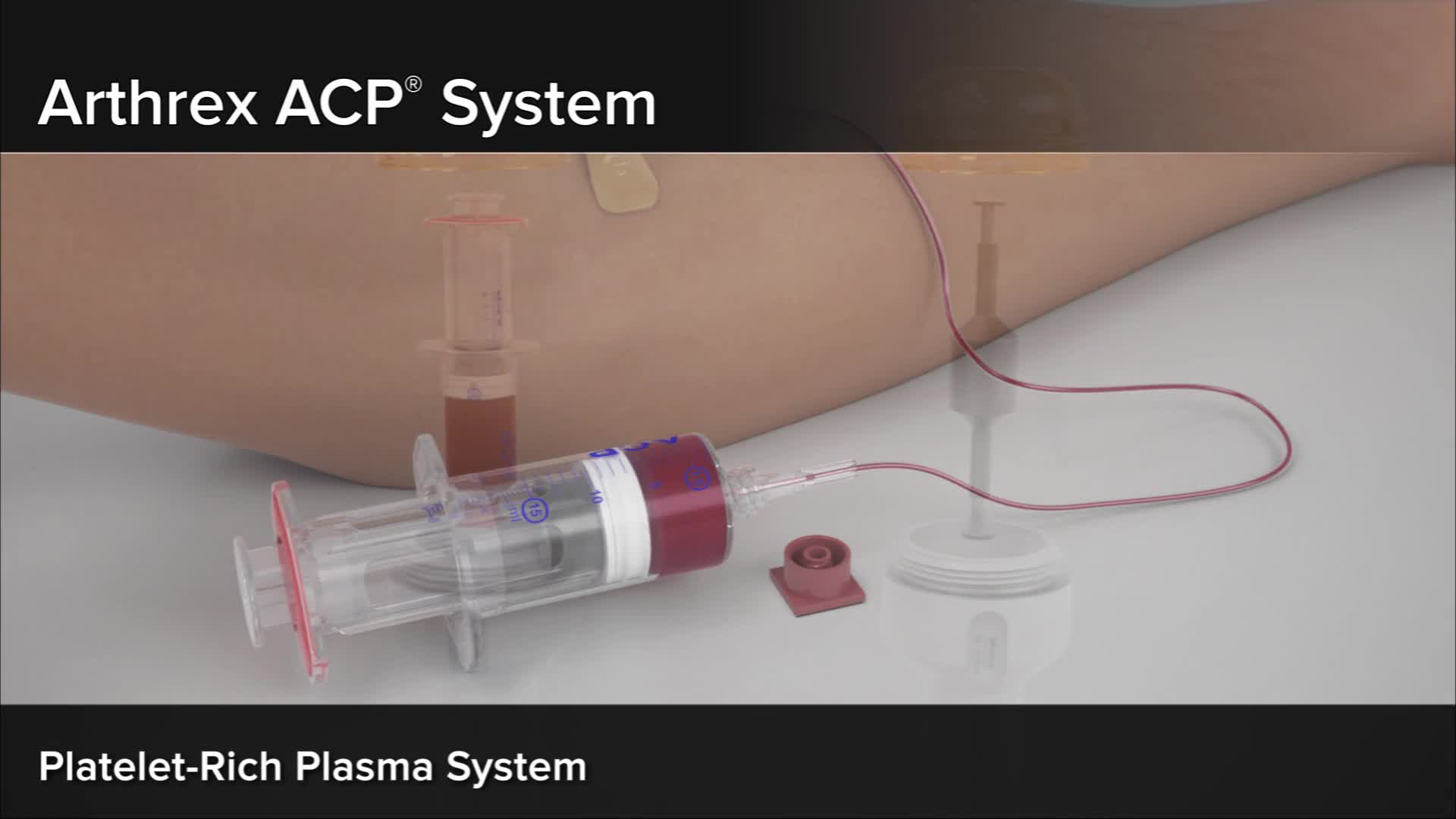 Arthrex - Arthrex ACP® System