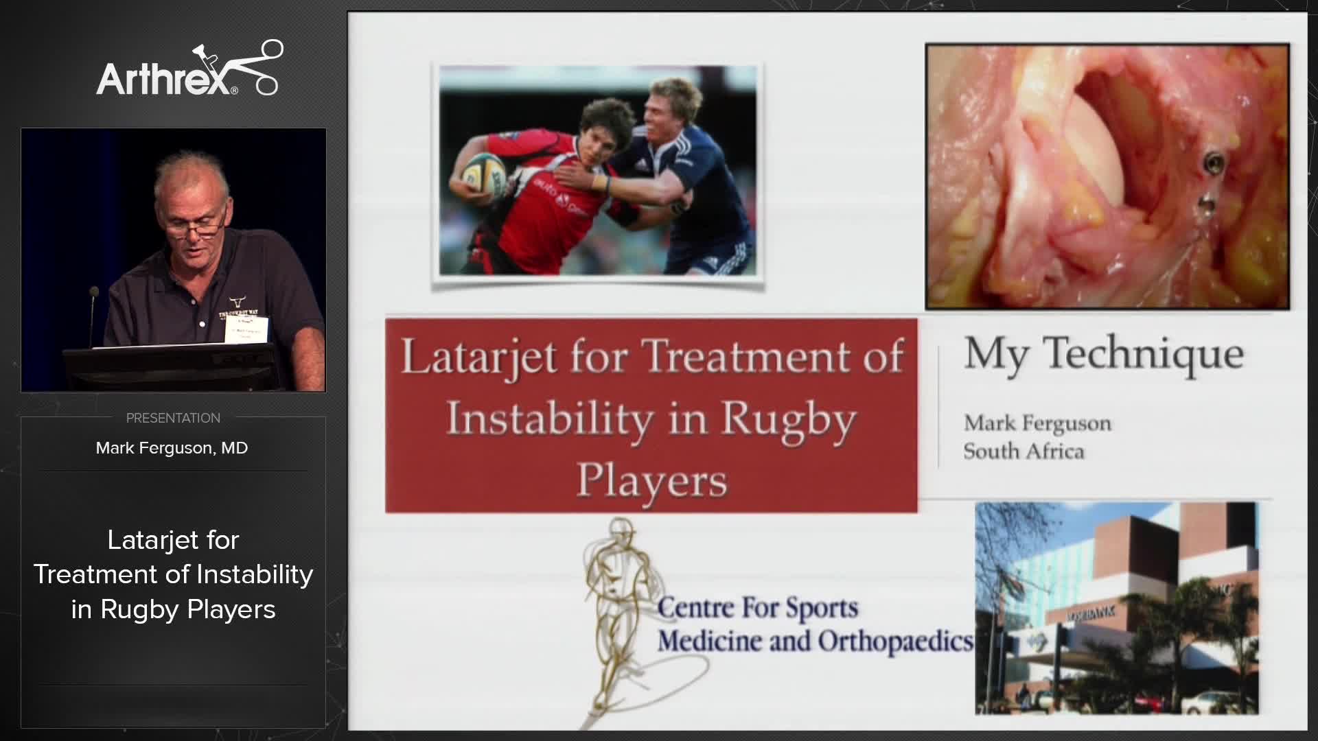 Arthrex - Latarjet for Treatment of Instability in Rugby Players
