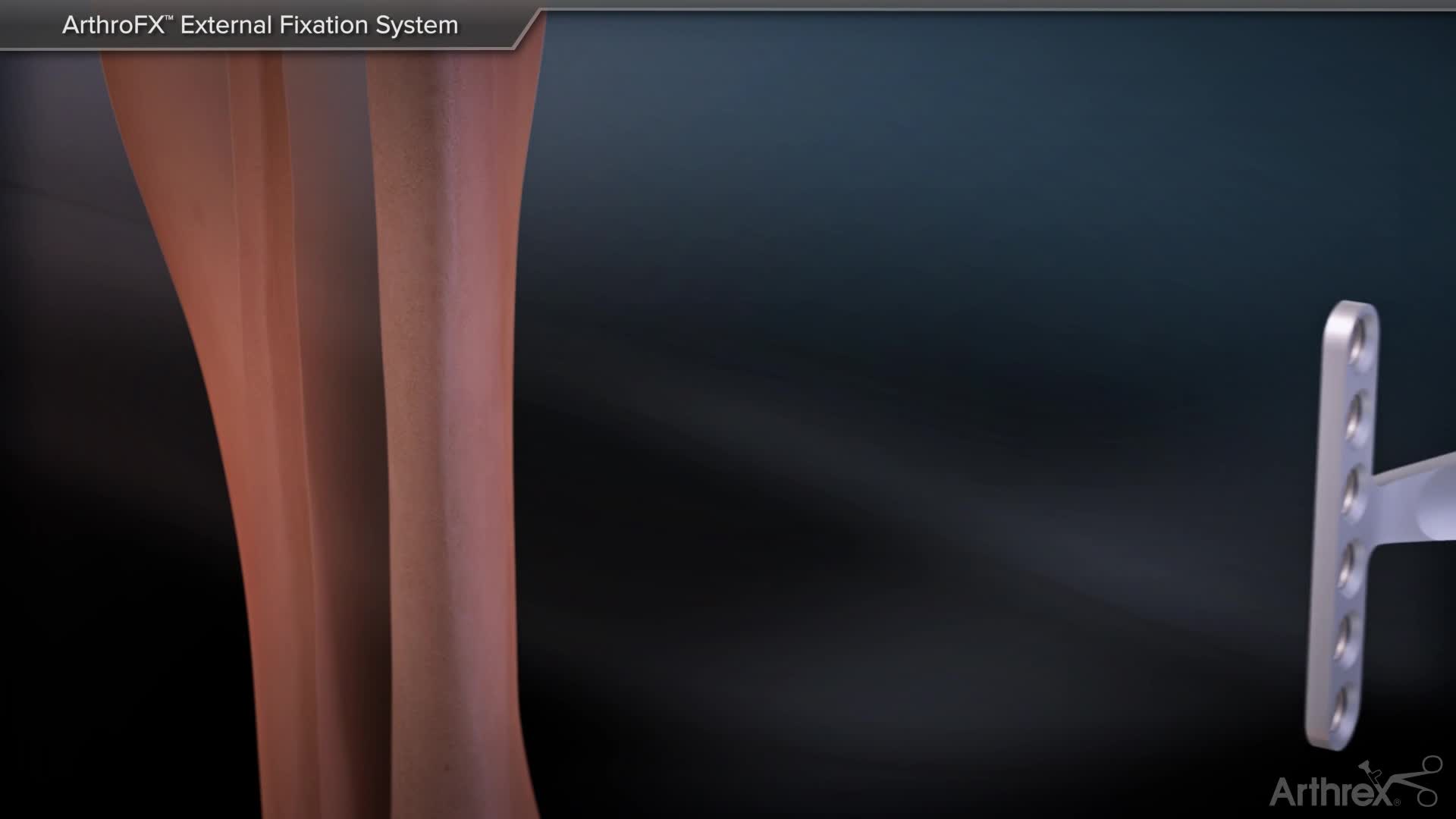 Arthrex - ArthroFX™ External Fixation System