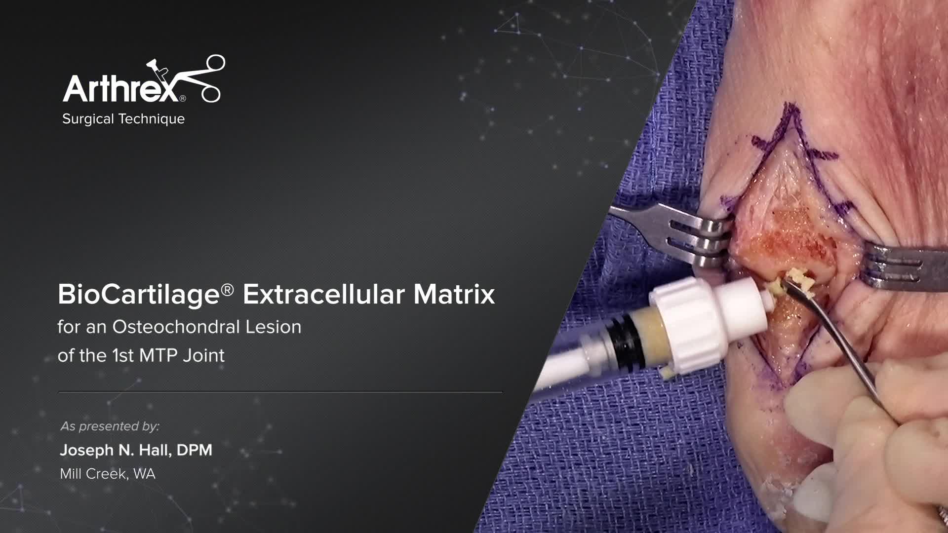 Arthrex - BioCartilage® Extracellular Matrix for an Osteochondral ...