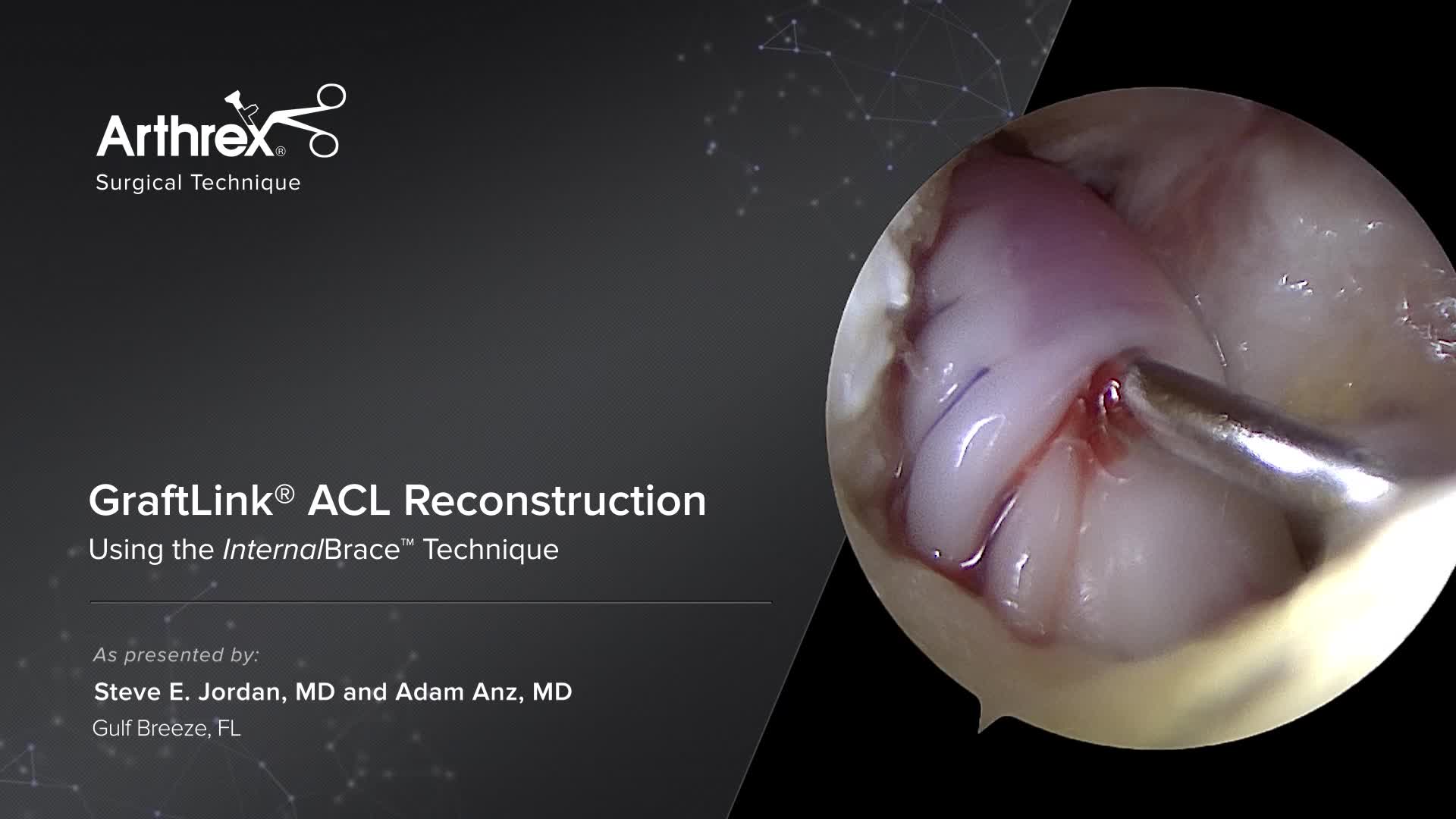 Arthrex - GraftLink® ACL Reconstruction Using the InternalBrace™ Technique
