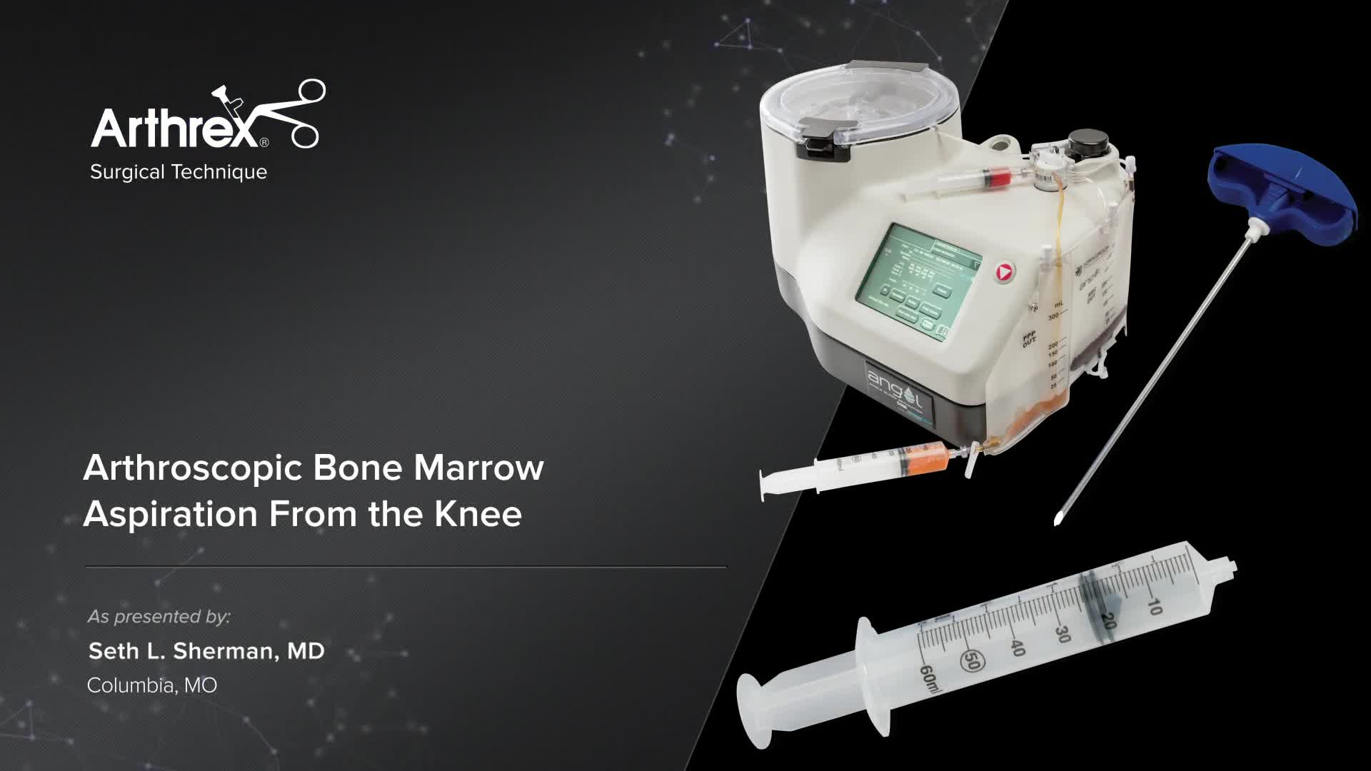 Arthrex - Arthroscopic Bone Marrow Aspiration From the Knee