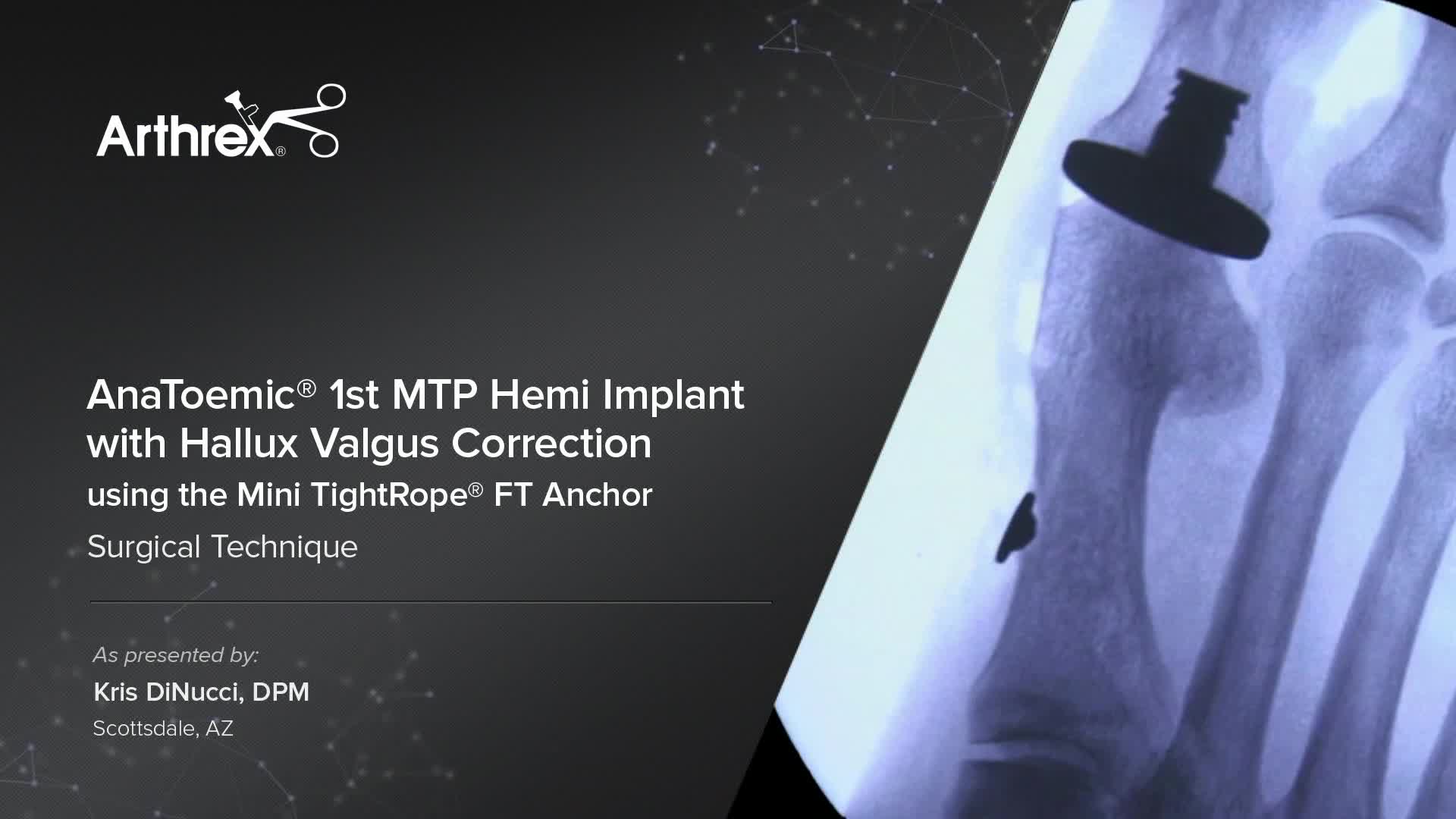 Arthrex - AnaToemic® 1st MTP Hemi Implant with Hallux Valgus Correction ...