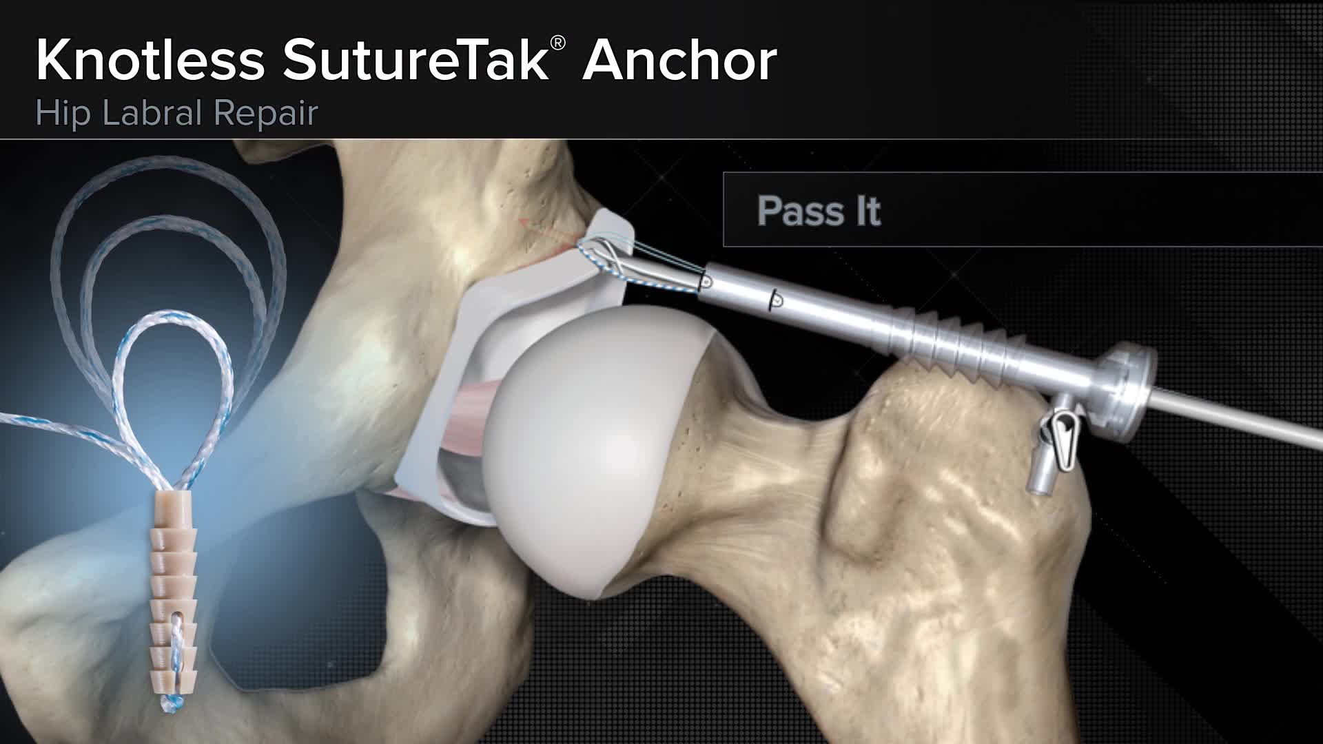 Arthrex Knotless Suturetak® Anchor Hip Labral Repair