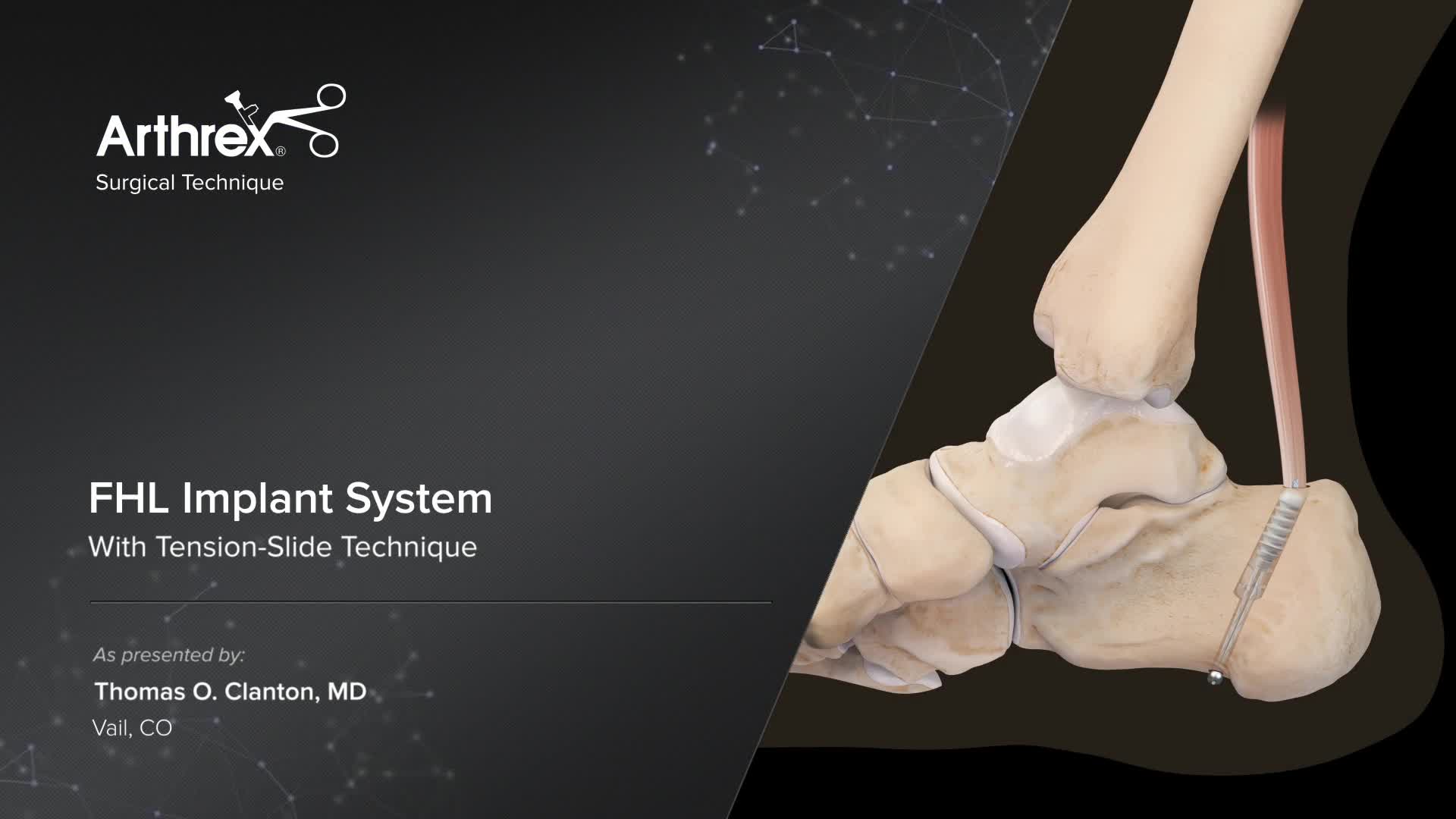 Arthrex - FHL Implant System With Tension-Slide Technique