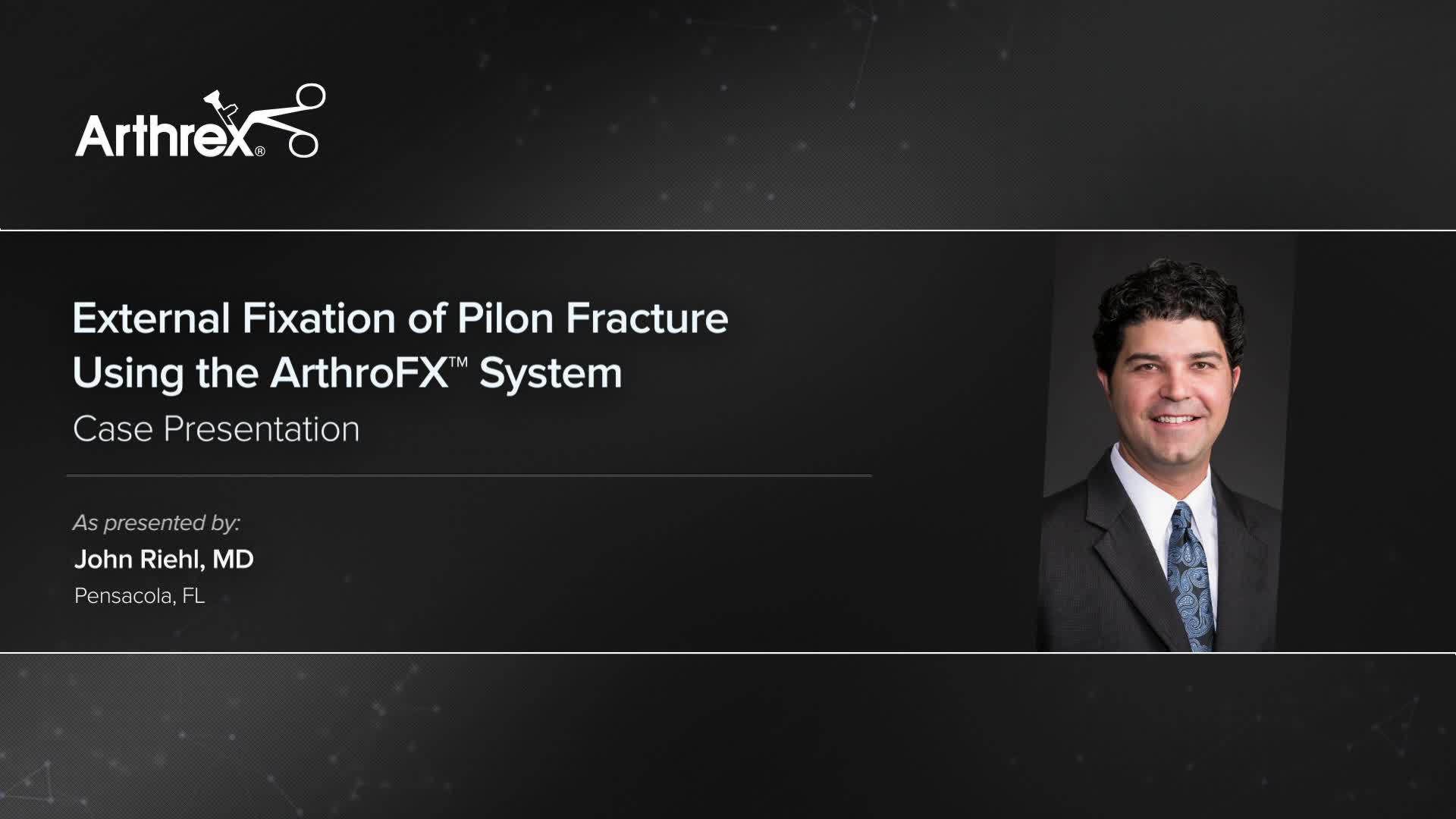 Arthrex - External Fixation of Pilon Fracture Using the ArthroFX™ System
