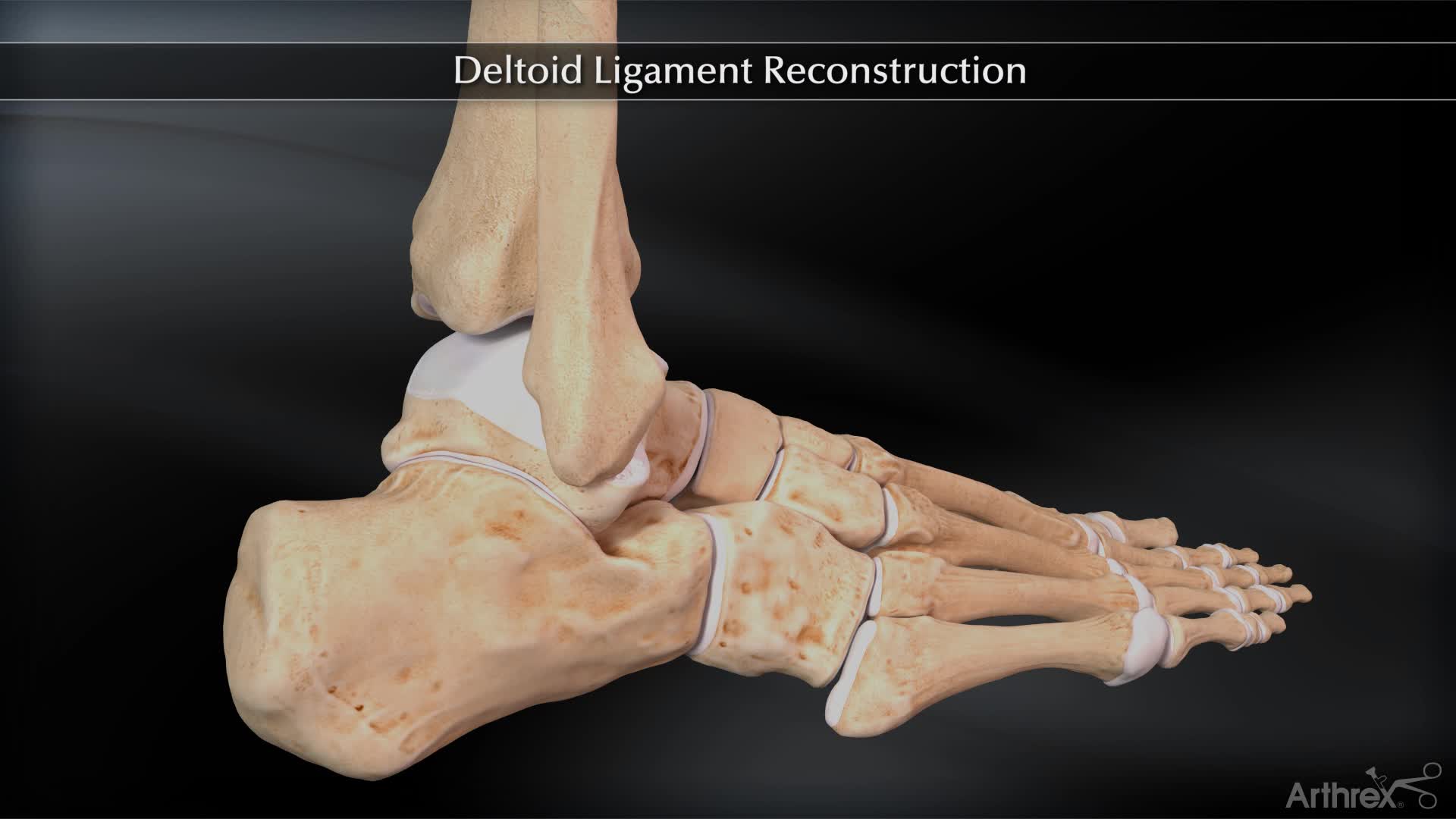 Arthrex - Deltoid Ligament Reconstruction