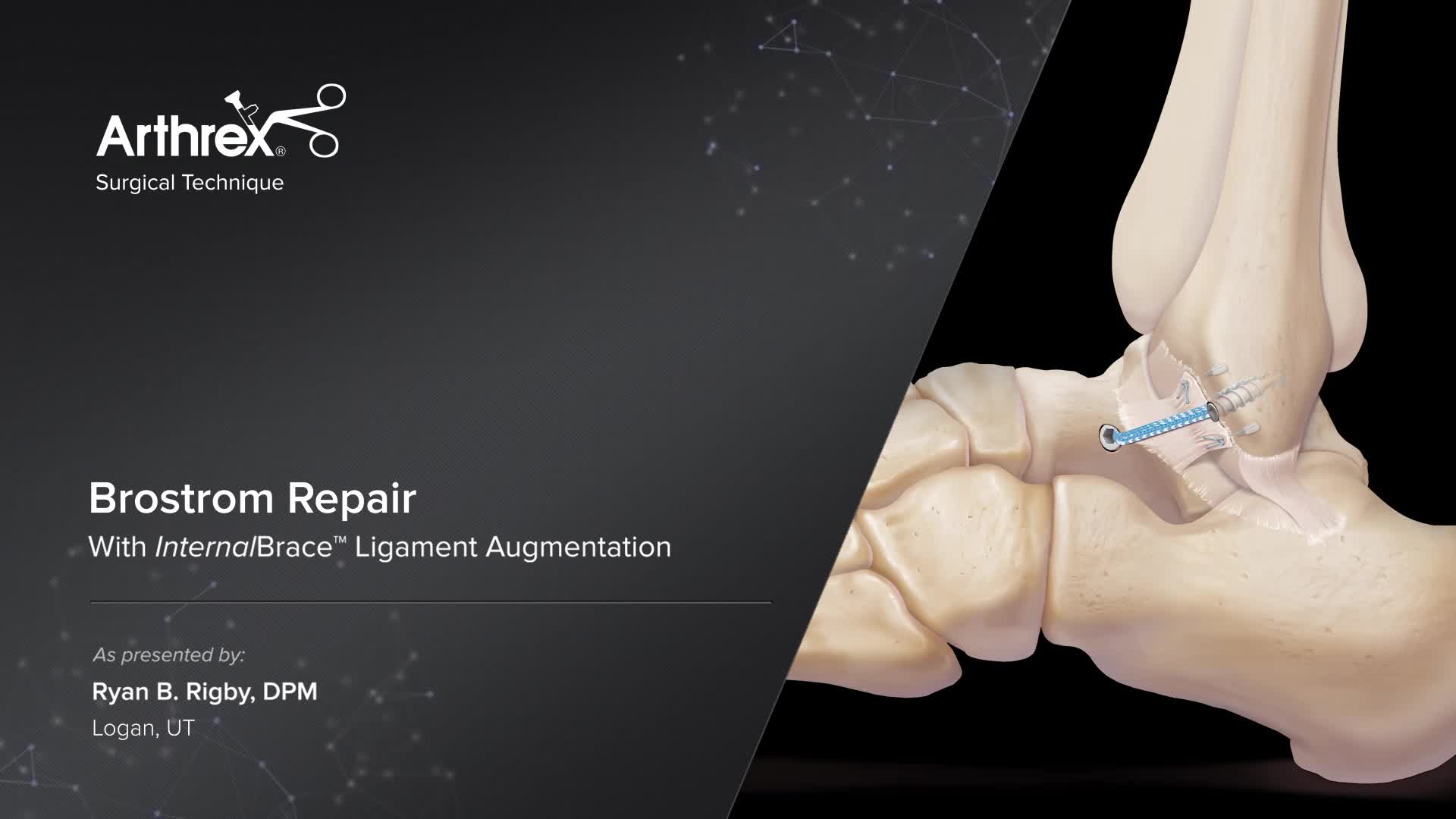 Arthrex - Brostrom Repair With InternalBrace™ Ligament Augmentation ...