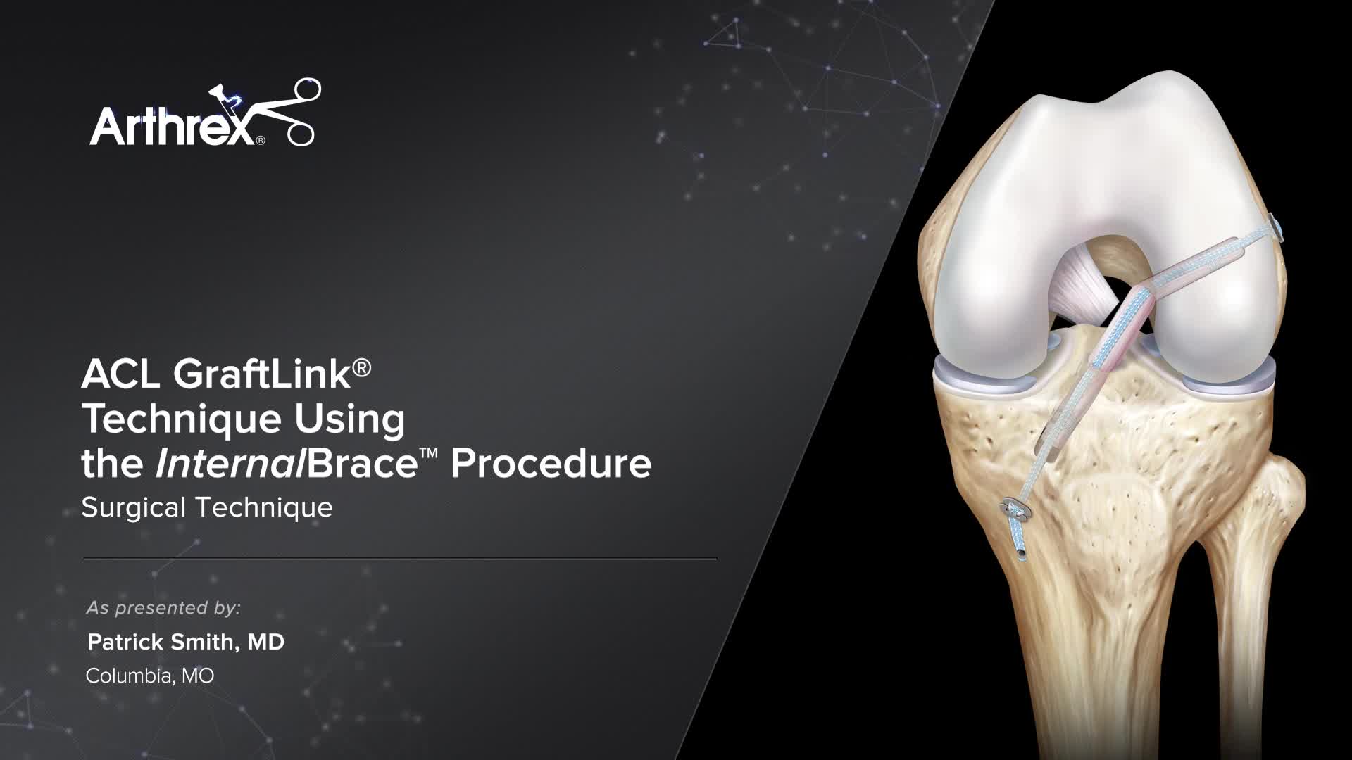 Arthrex - ACL GraftLink® Technique Using the InternalBrace™ Procedure