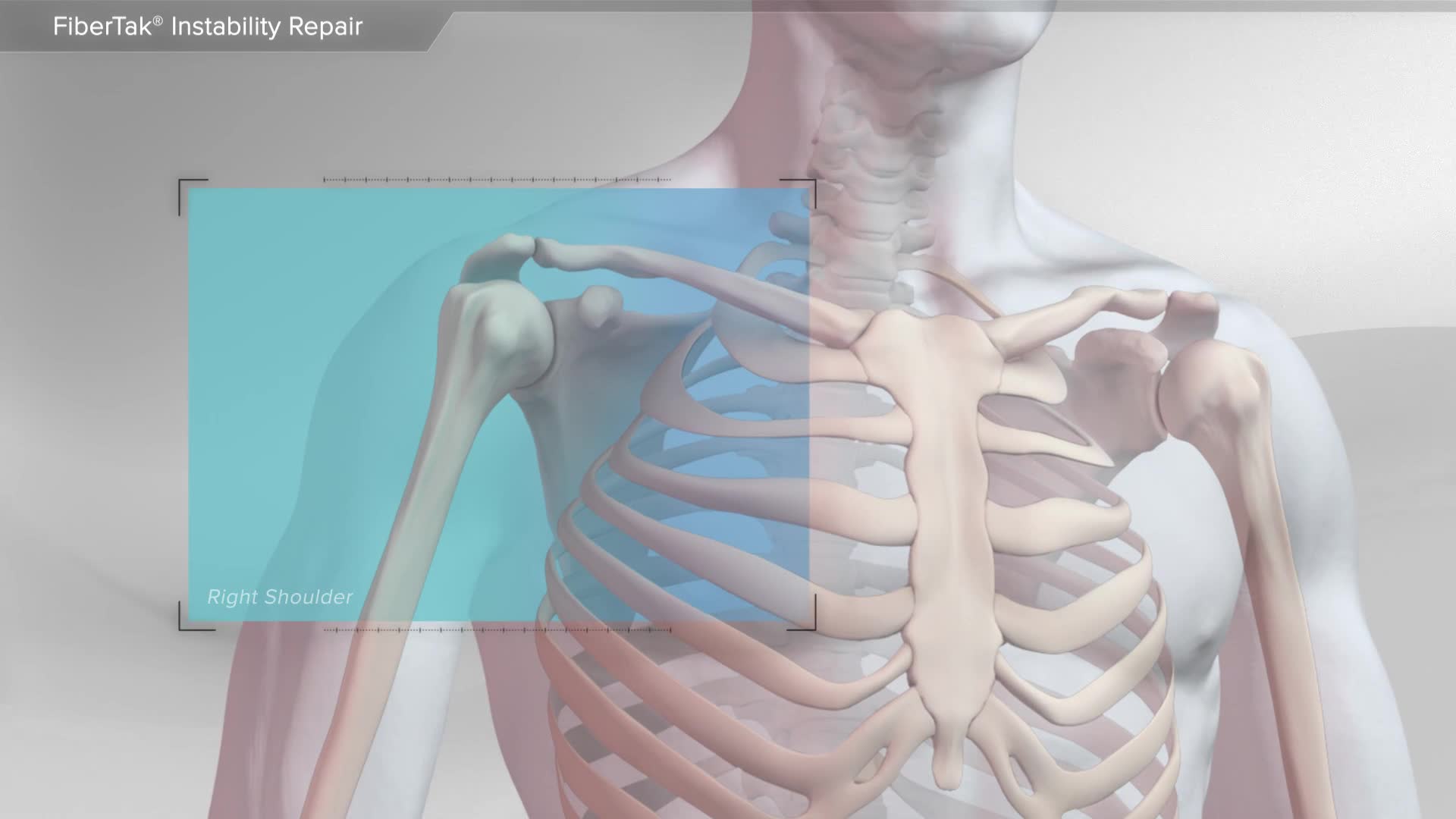 Arthrex - FiberTak® Instability Repair