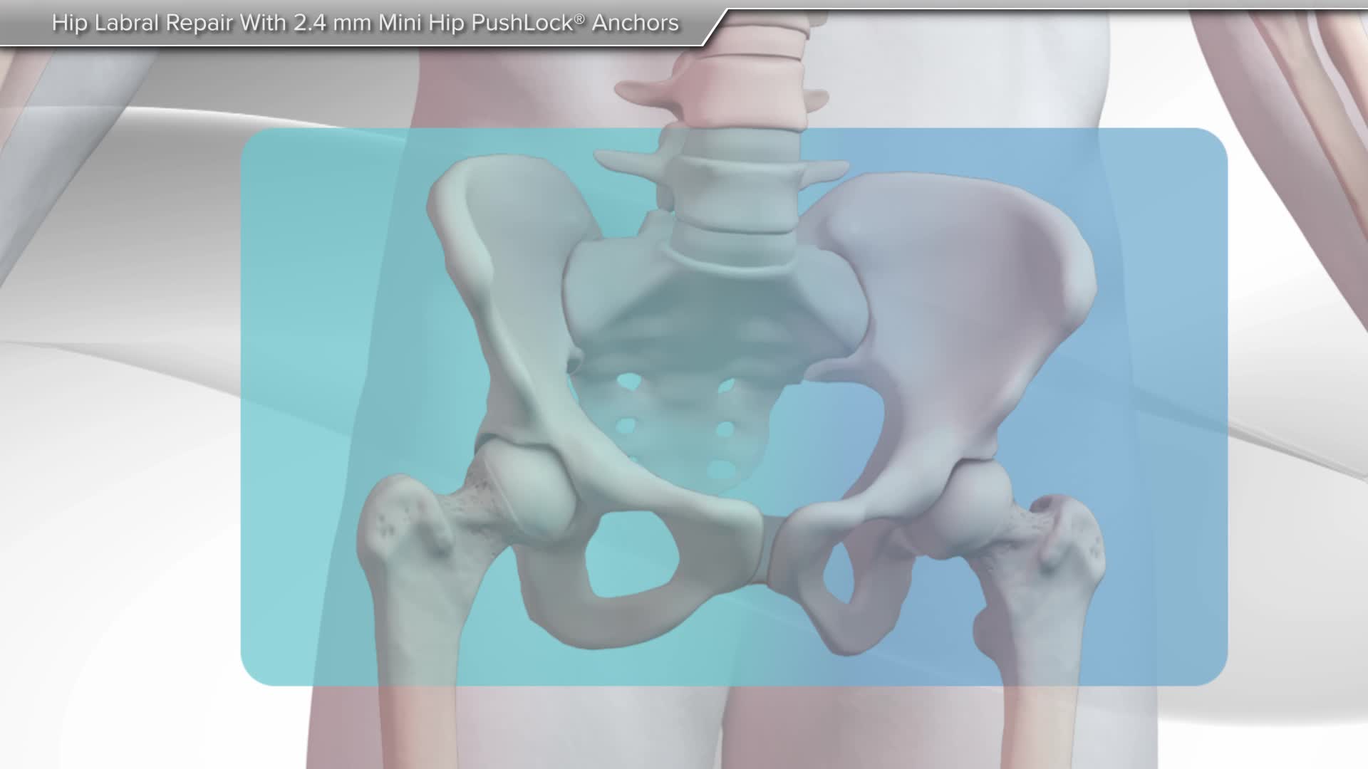 Arthrex - Hip Labral Repair With 2.4 mm Mini Hip PushLock® Anchors