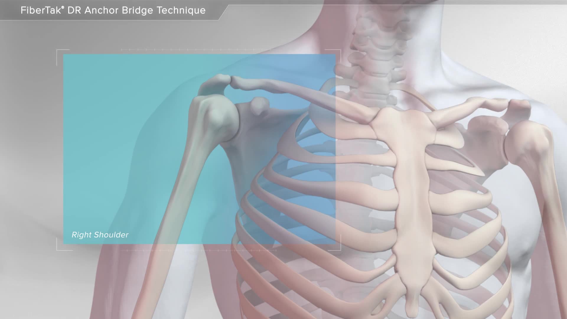 Arthrex - FiberTak® DR Anchor Bridge Technique