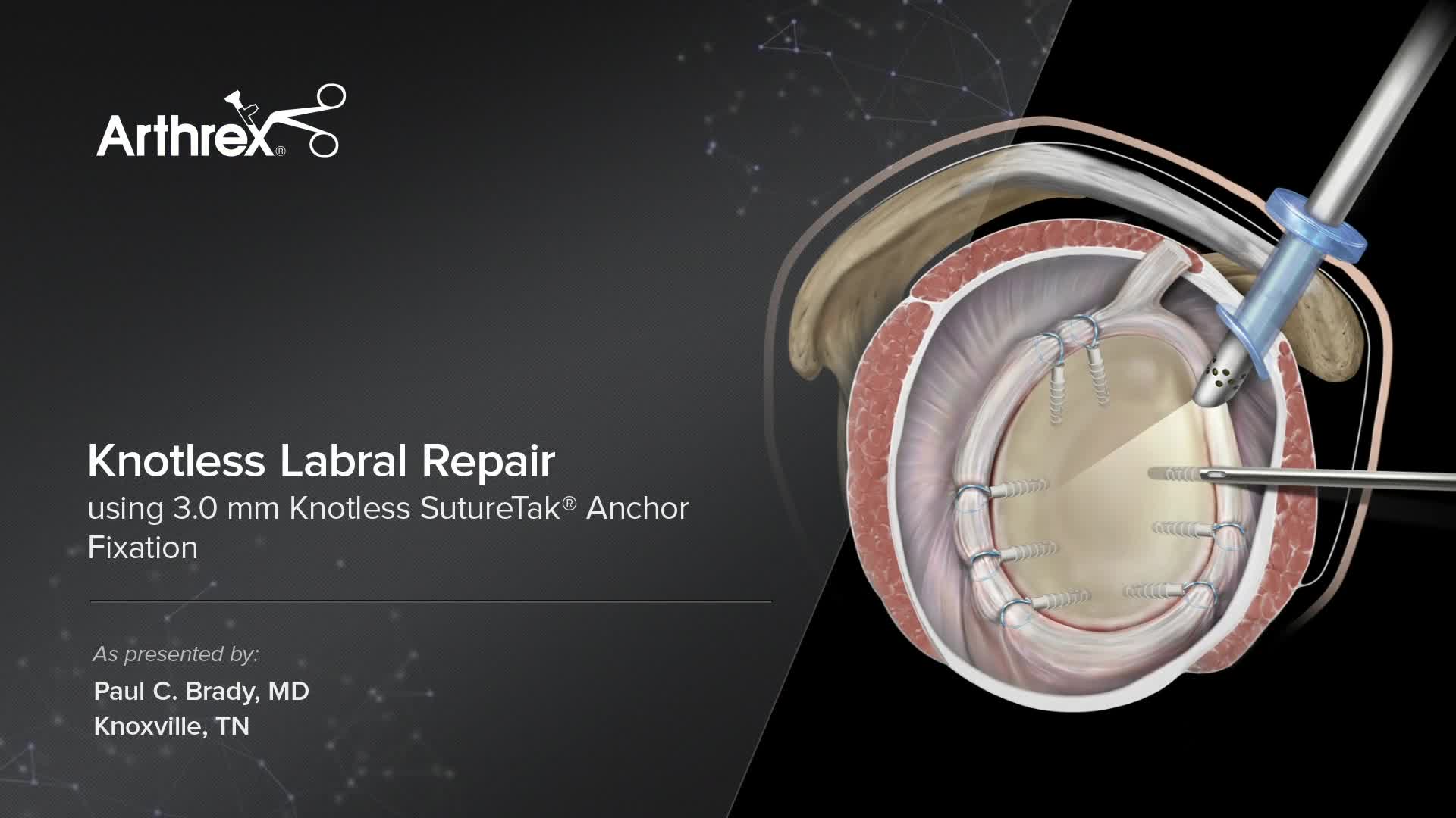 Arthrex - Knotless Labral Repair Using 3.0 mm Knotless SutureTak ...