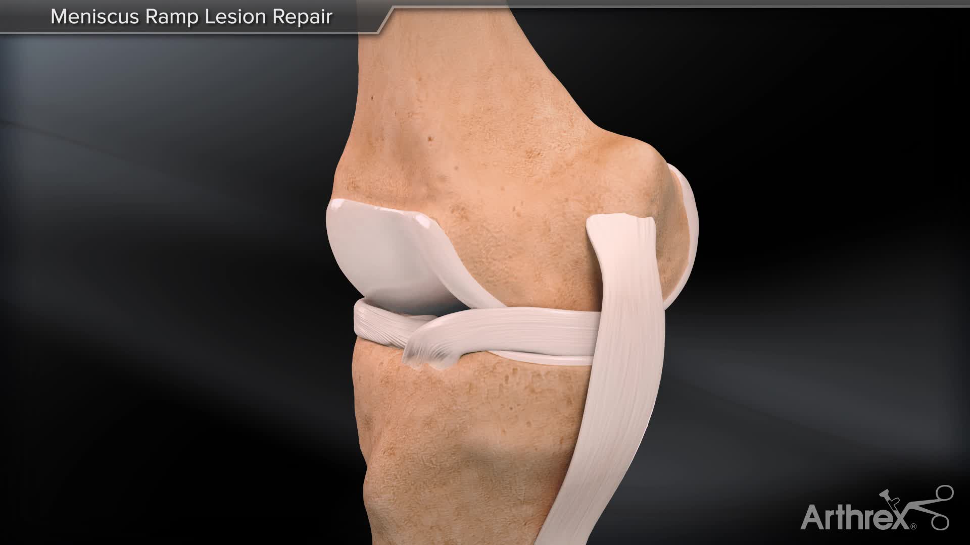 Arthrex - Meniscus Ramp Lesion Repair