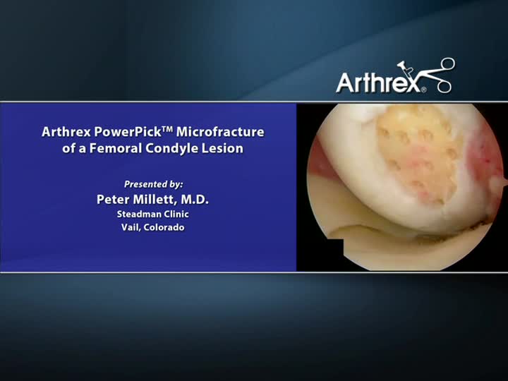 Arthrex - Arthrex PowerPick™ Microfracture of a Femoral Condyle Lesion