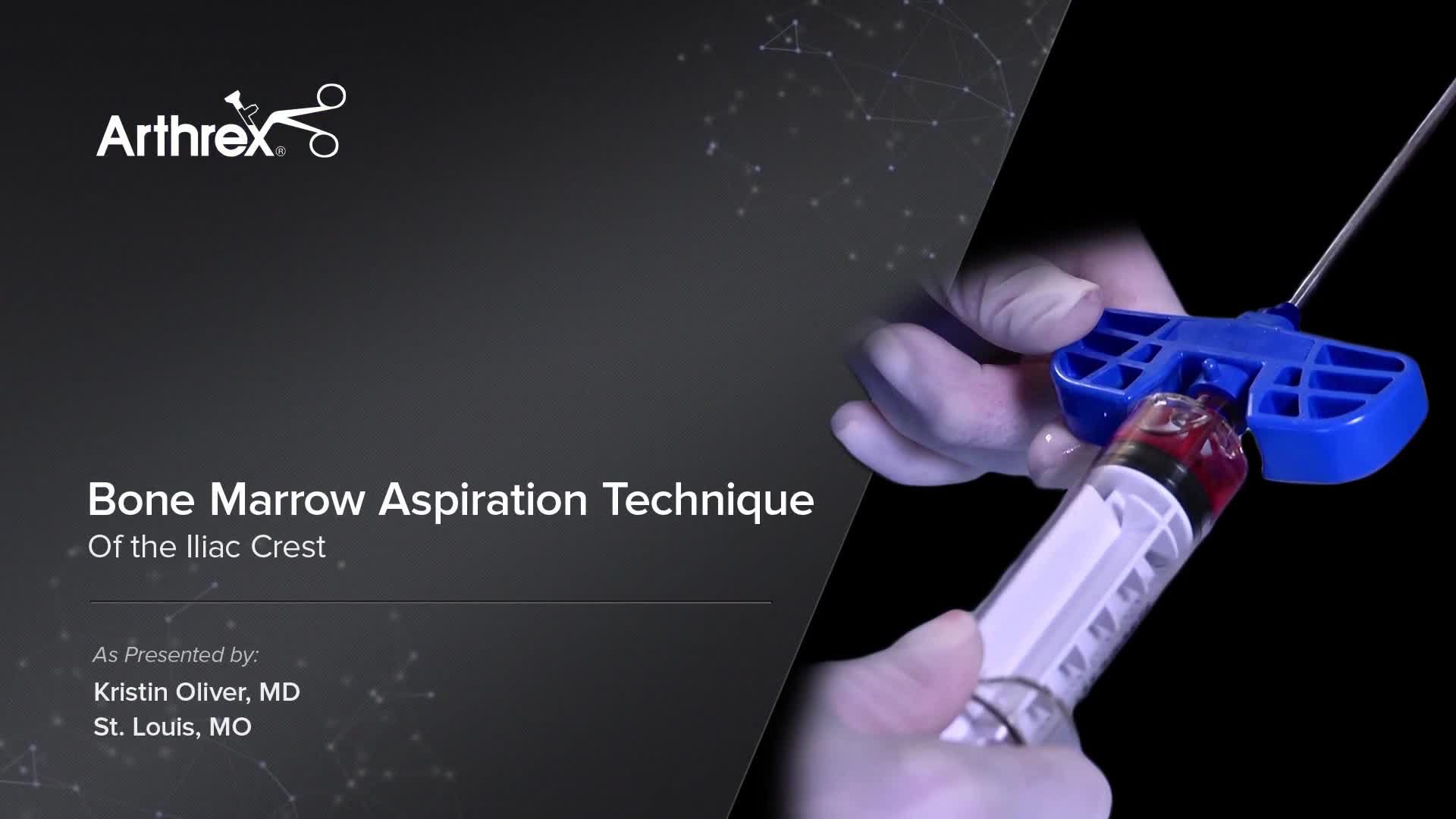 Arthrex - Bone Marrow Aspirate Harvesting Technique