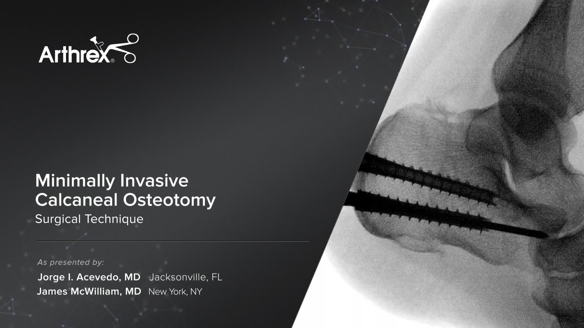Arthrex - Minimally Invasive Calcaneal Osteotomy