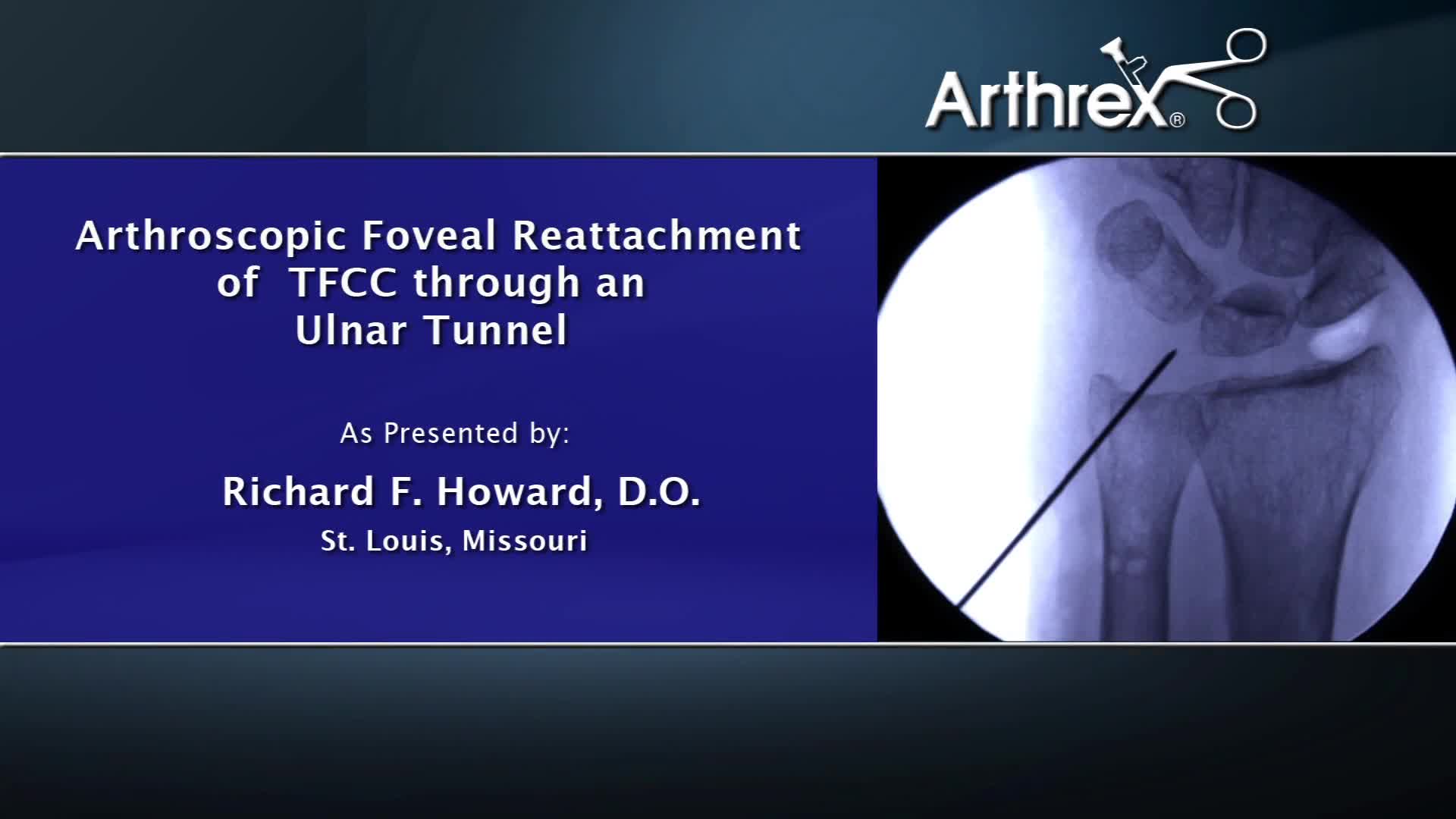 Arthrex - Arthroscopic Foveal Reattachment of TFCC through an Ulnar Tunnel