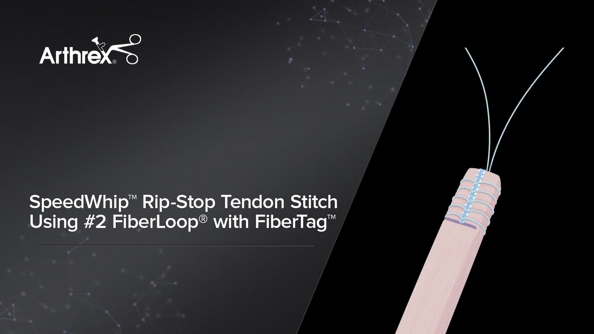 Arthrex - SpeedWhip™ Rip-Stop Tendon Stitch using #2 FiberLoop® with ...