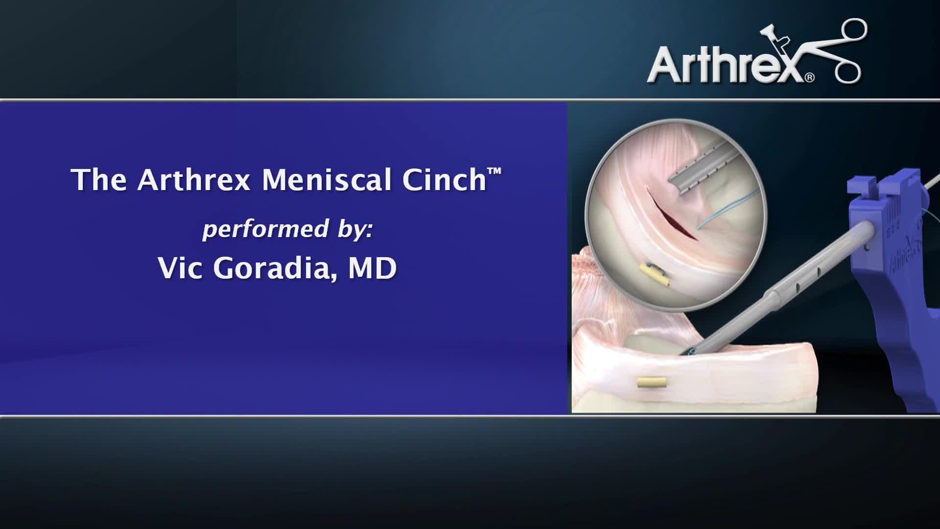 Arthrex - The Arthrex Meniscal Cinch™