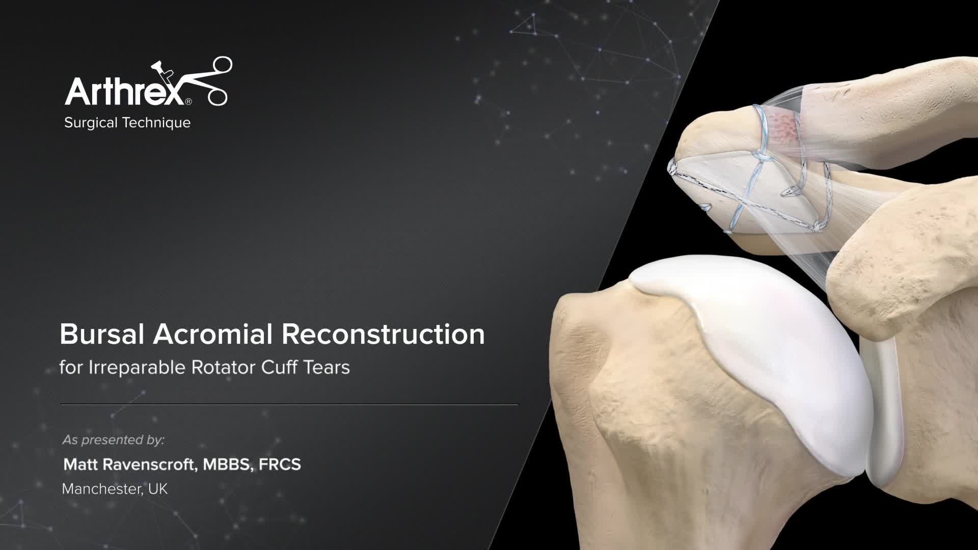Arthrex - Bursal Acromial Reconstruction for Irreparable Rotator Cuff Tears