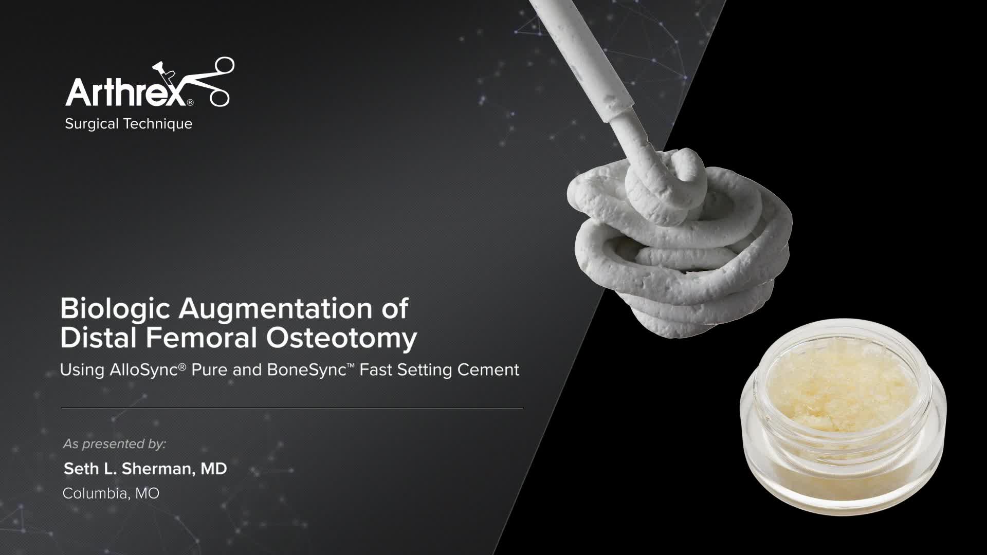 Arthrex - Biologic Augmentation of Distal Femoral Osteotomy Using ...