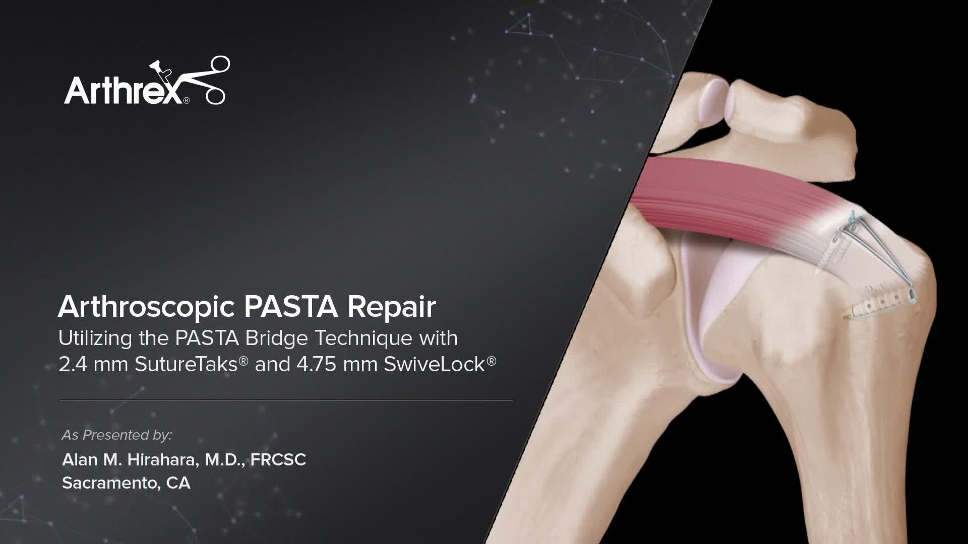 Arthrex - Arthroscopic PASTA Repair Utilizing the PASTA Bridge Technique