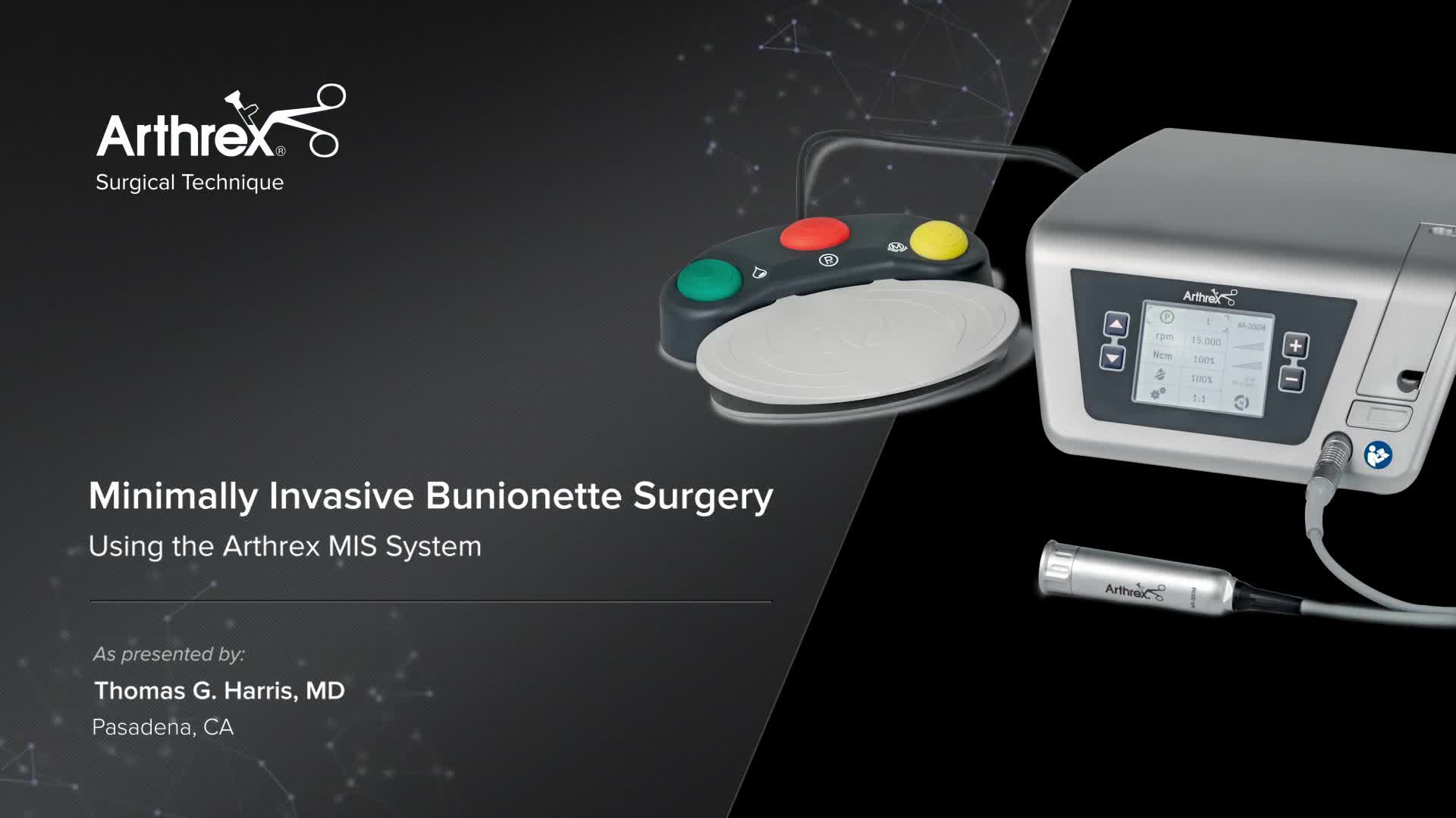 Arthrex - Minimally Invasive Bunionette Surgery Using the Arthrex MIS ...