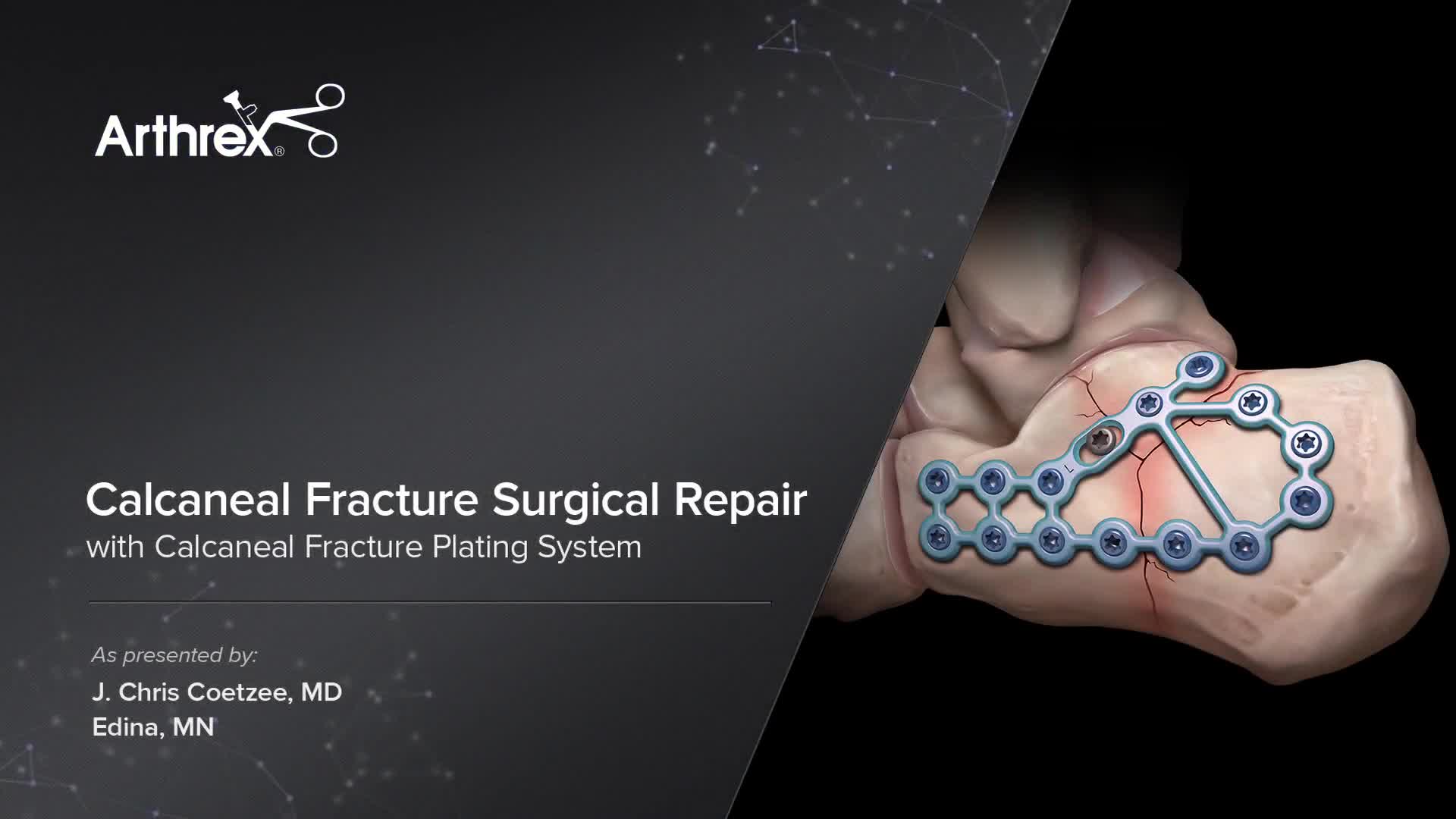 Arthrex - Calcaneal Fracture Surgical Repair with Calcaneal Fracture ...