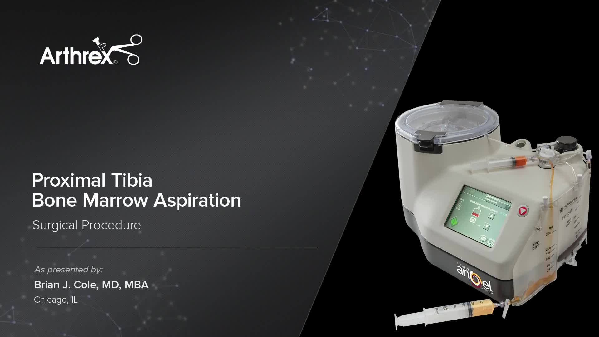 Arthrex - Proximal Tibia Bone Marrow Aspiration