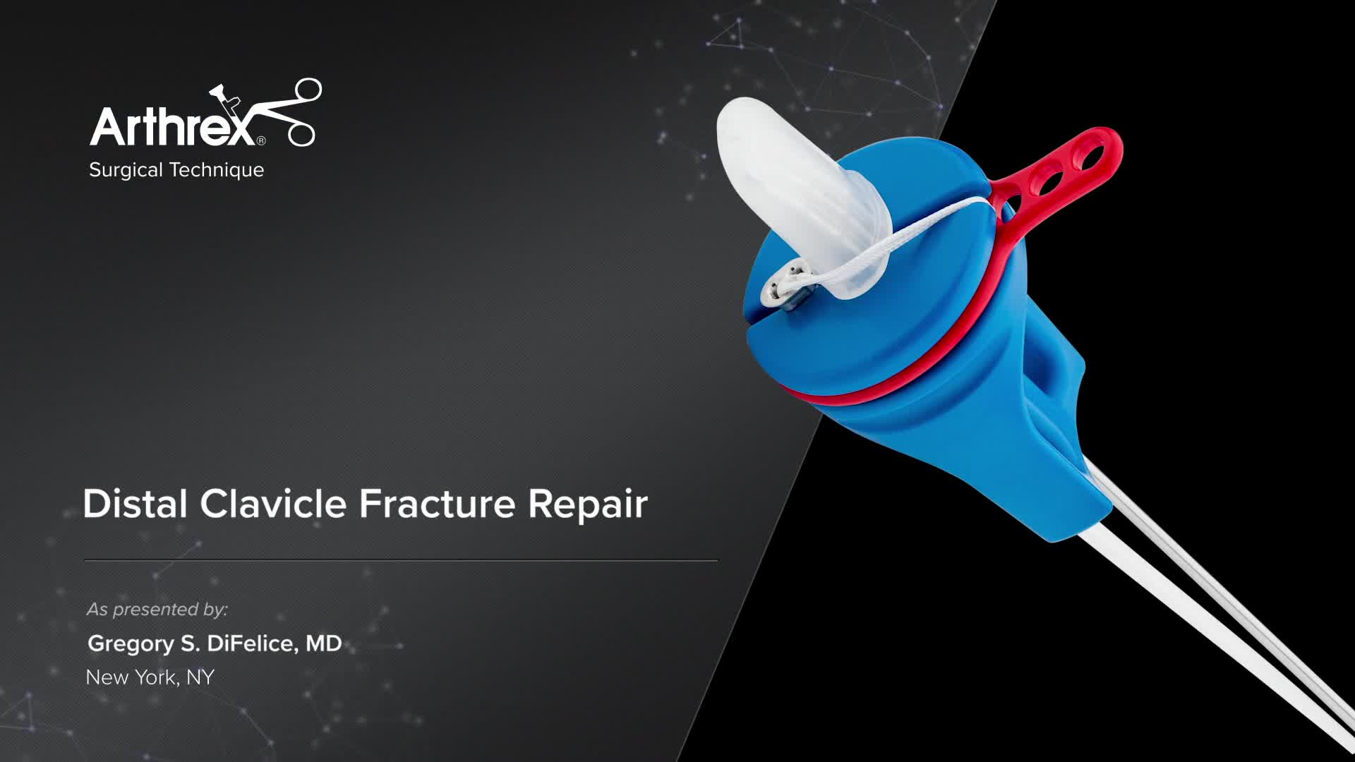 Arthrex - Distal Clavicle Fracture Repair