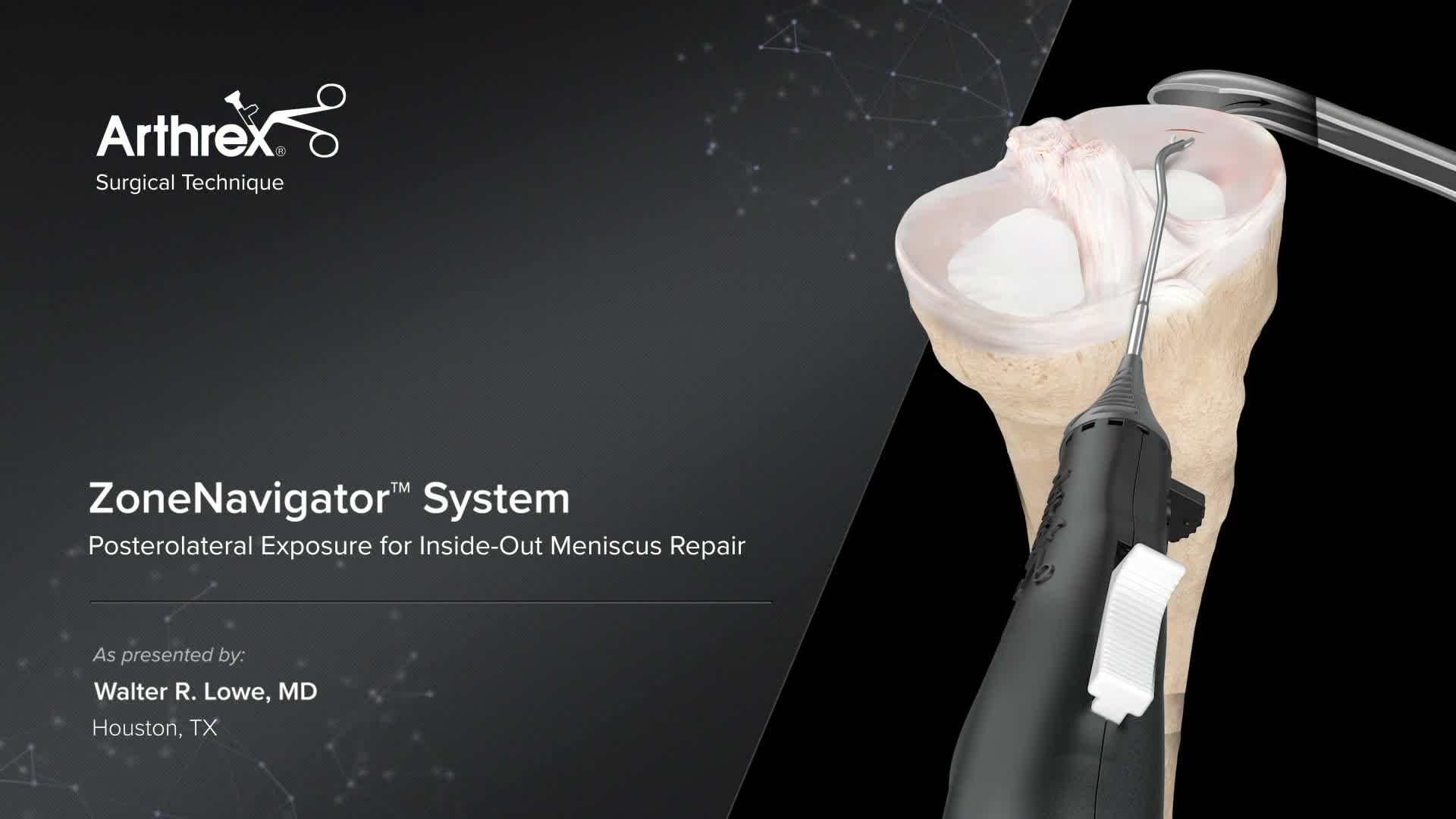Arthrex - ZoneNavigator™ System Posterolateral Exposure for Inside-Out ...