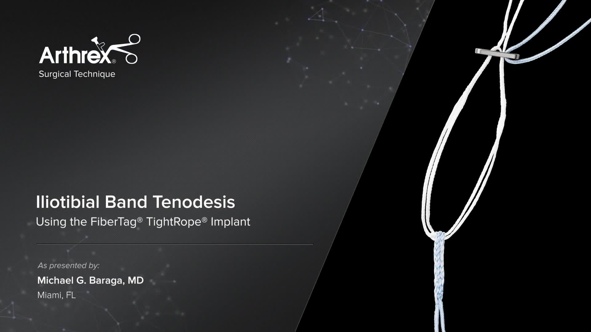 Arthrex - Iliotibial Band Tenodesis Using the FiberTag® TightRope® Implant