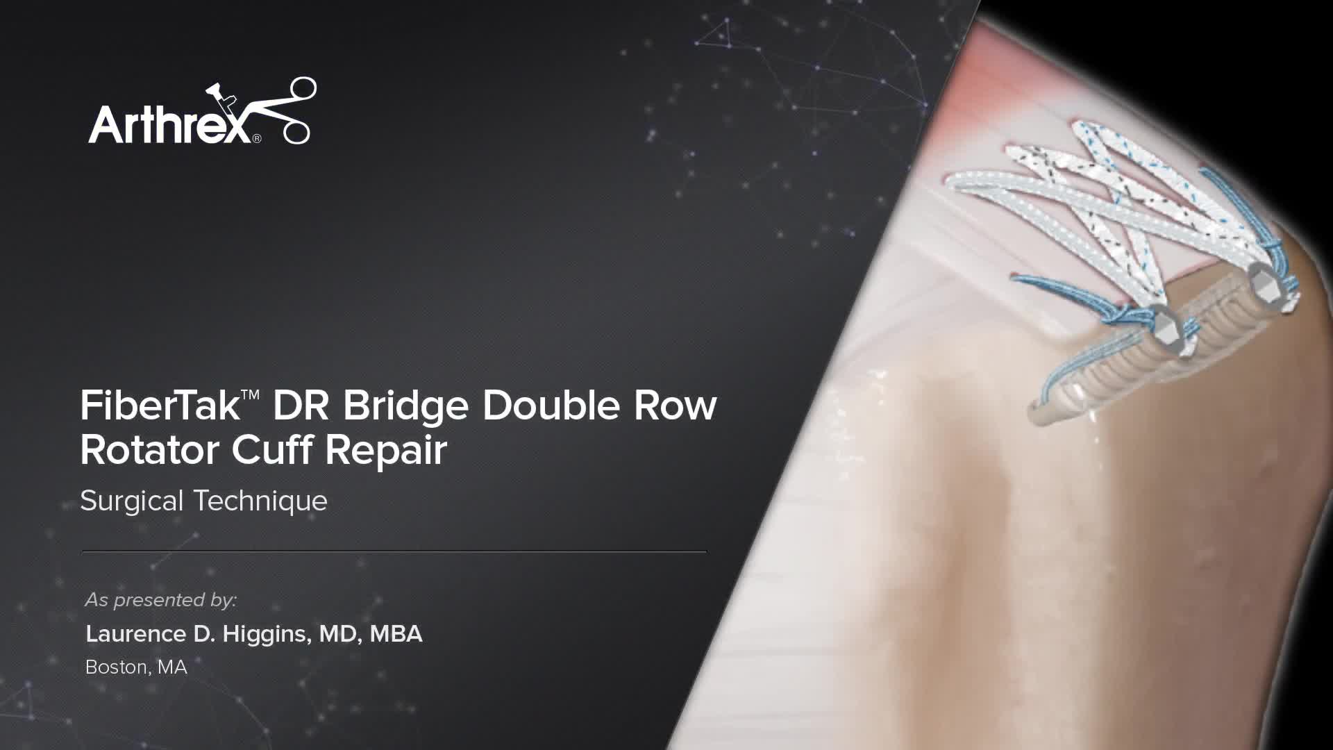 Arthrex - FiberTak™ DR Bridge Double Row Rotator Cuff Repair