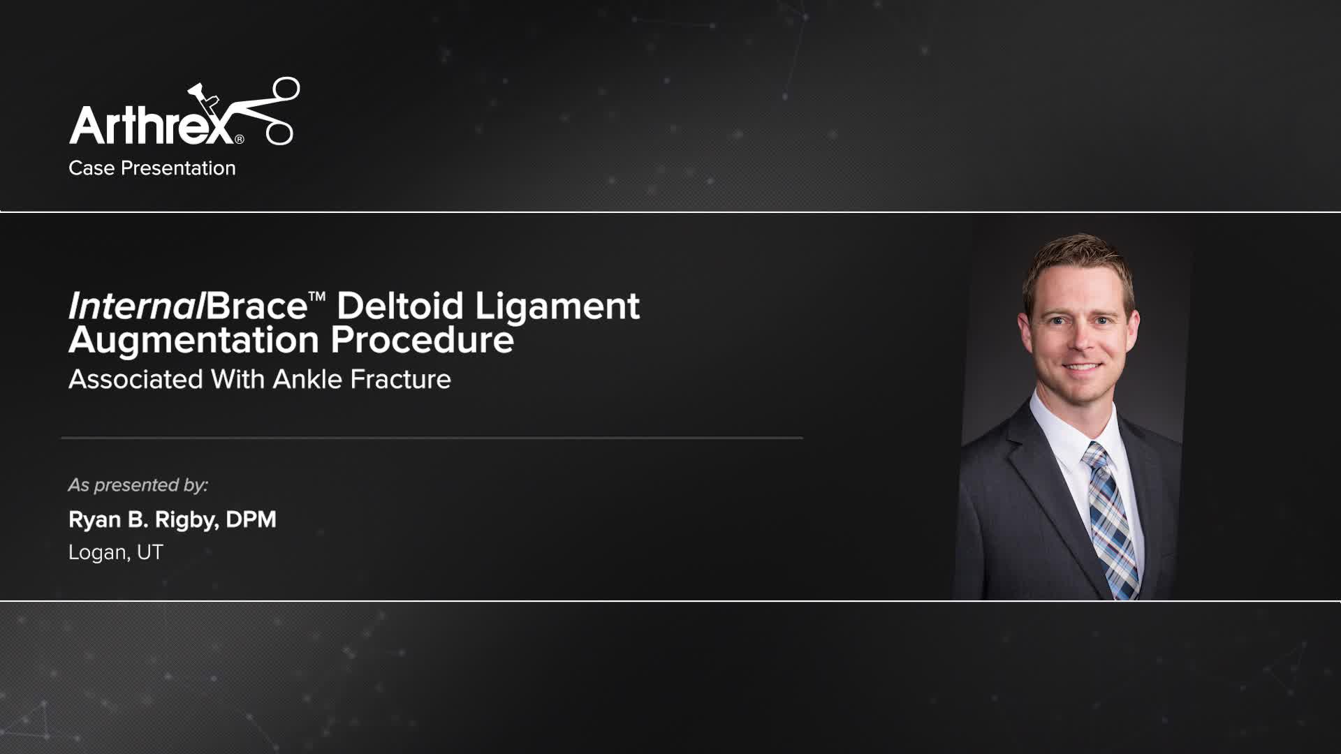 Arthrex - InternalBrace™ Deltoid Augmentation Procedure Associated With ...