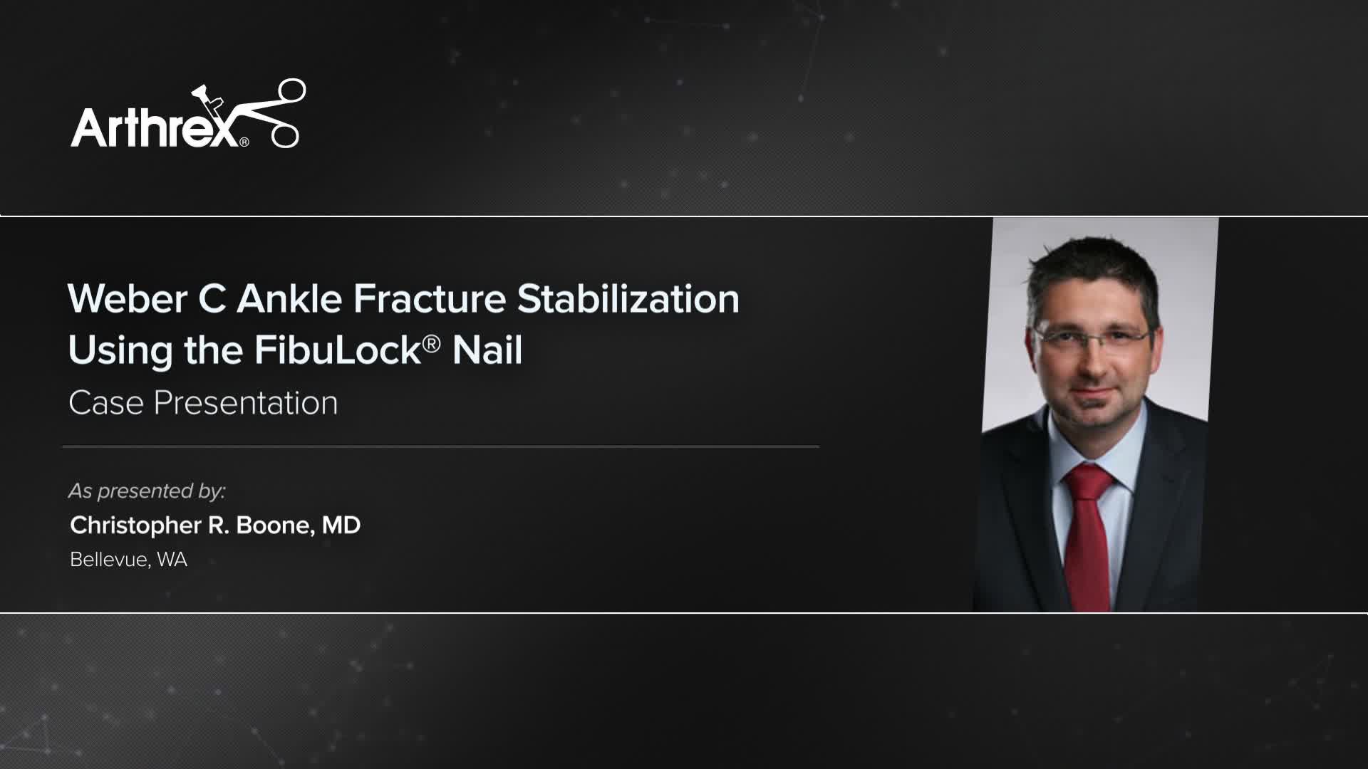 Arthrex - Weber C Ankle Fracture Stabilization Using the FibuLock® Nail