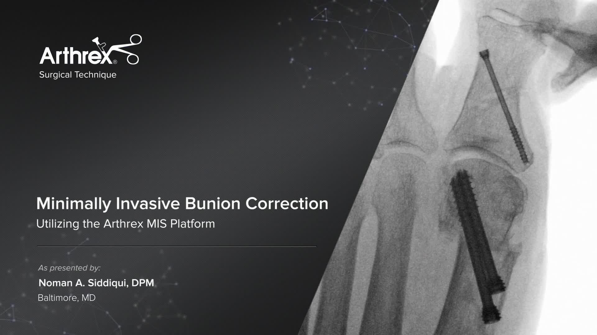 Arthrex - Minimally Invasive Bunion Correction Utilizing the Arthrex ...