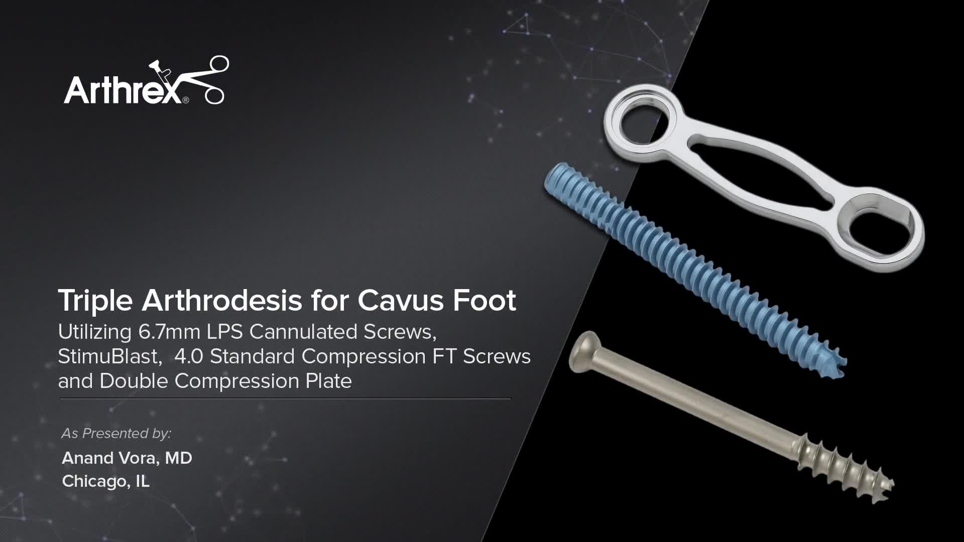 Arthrex - Triple Arthrodesis for Cavus Foot Utilizing 6.7mm LPS ...