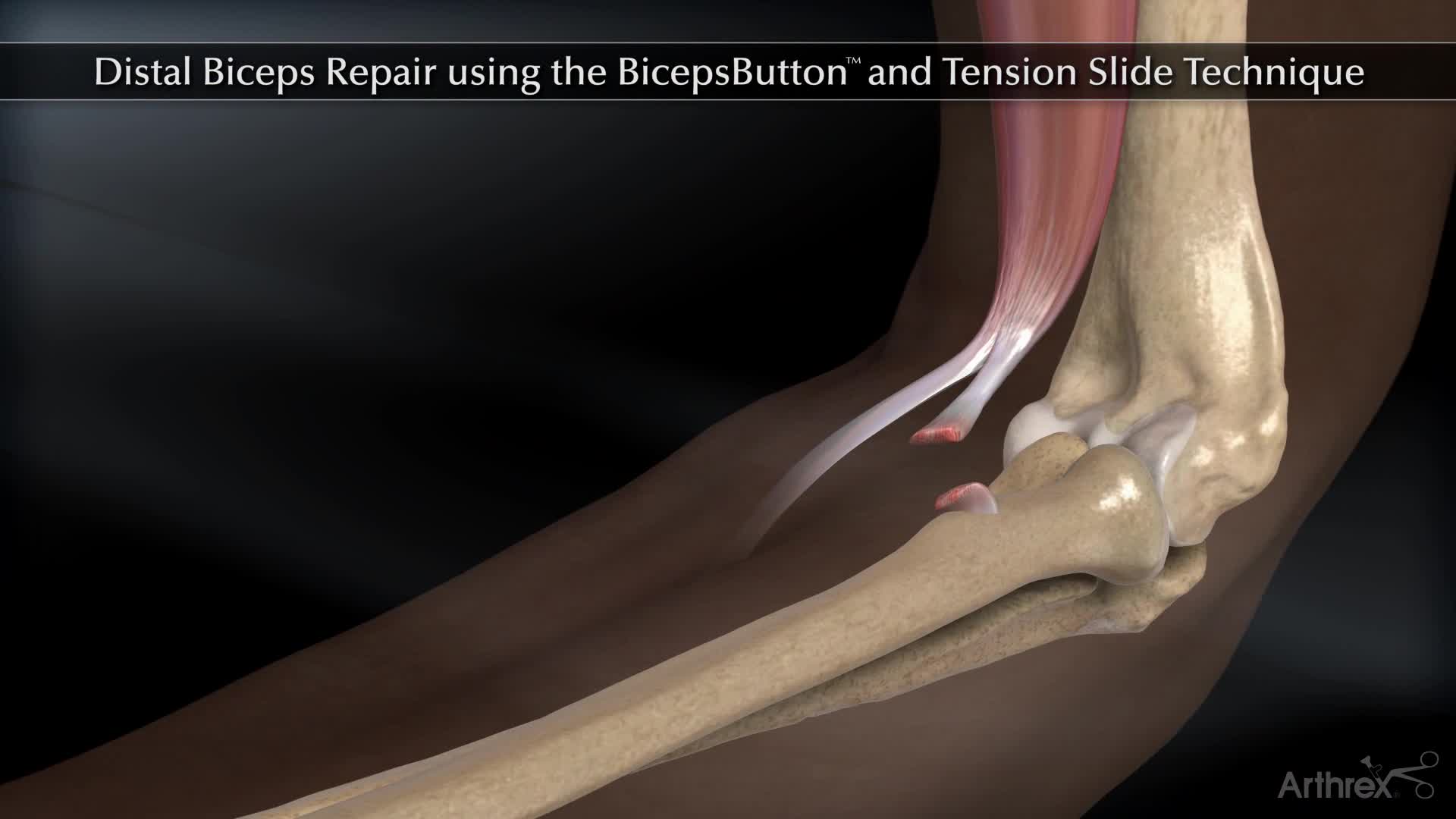 Arthrex - Distal Biceps Repair using the BicepsButton™ and Tension ...